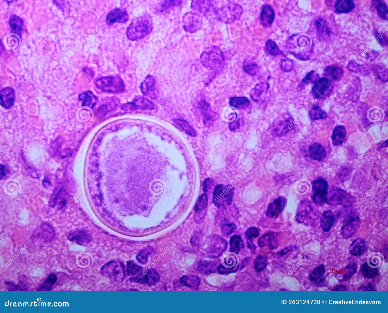 Coccidioides Imitis Spherule on H and E Pathology Specimen Stock Photo ...