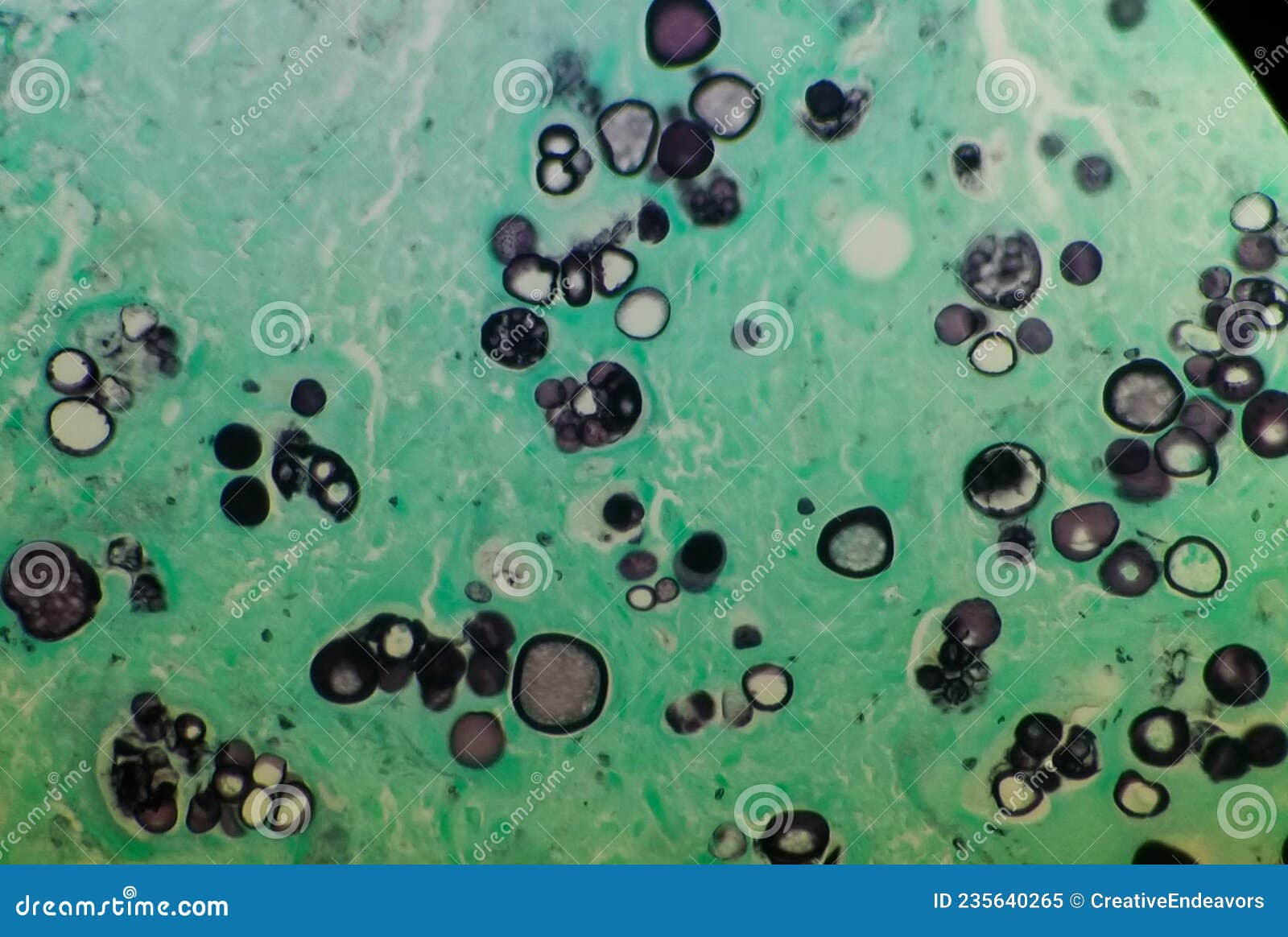 Coccidioides Imitis Spherules on GMS Pathology Specimen Stock Image ...