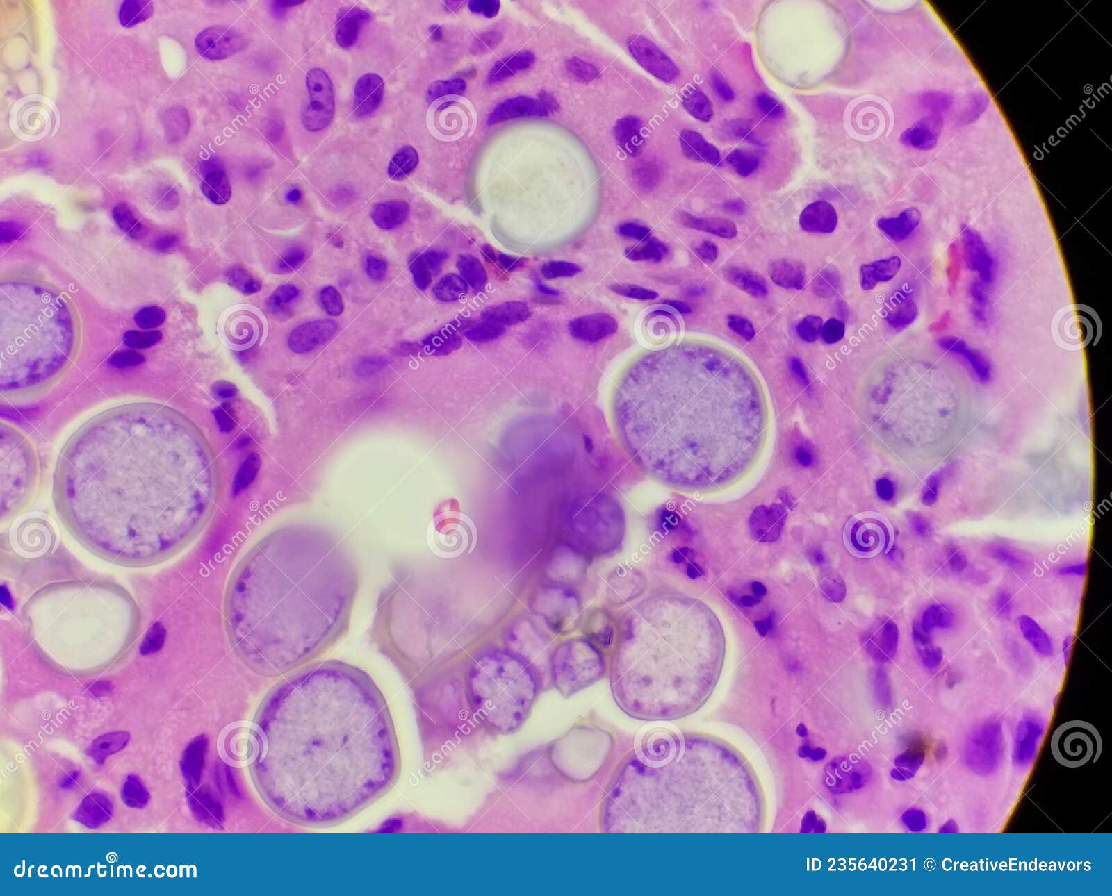 Coccidioides Imitis Spherules In Skin Biopsy Specimen Royalty-Free ...