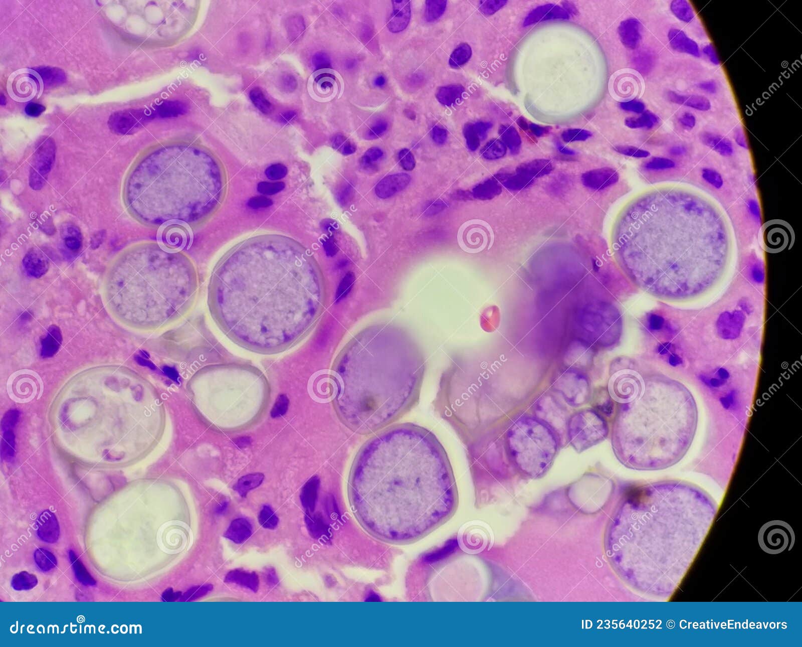 Coccidioides Imitis Spherules on H and E Pathology Specimen Stock Photo ...