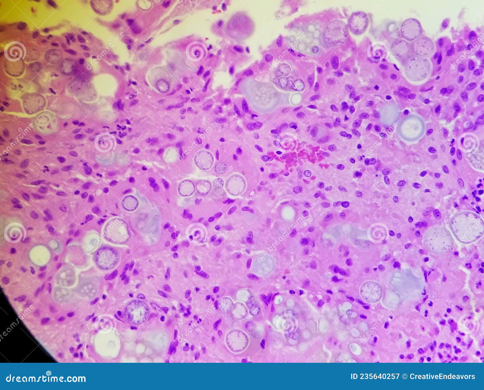 Coccidioides Imitis Spherules on H and E Pathology Specimen Stock Image ...