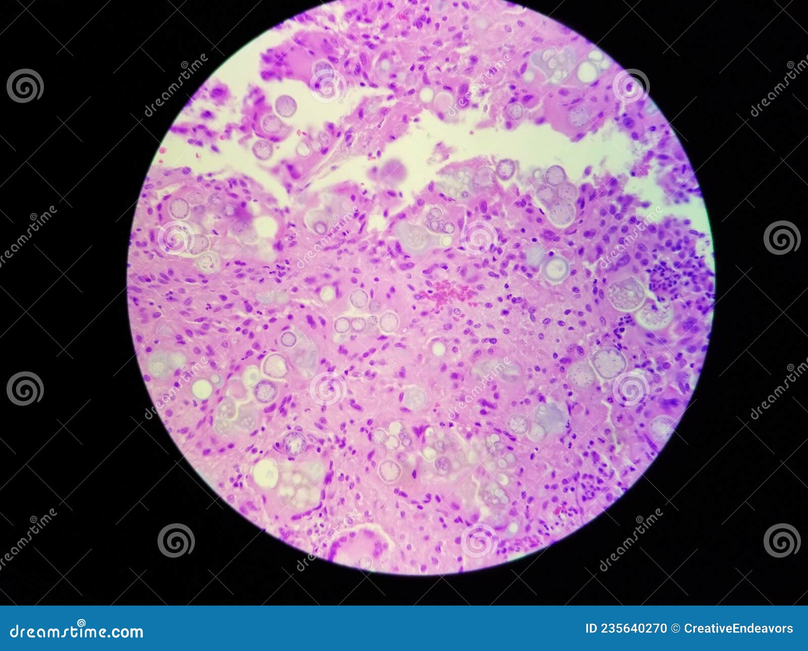 Coccidioides Imitis Spherules on H and E Pathology Specimen Stock Photo ...