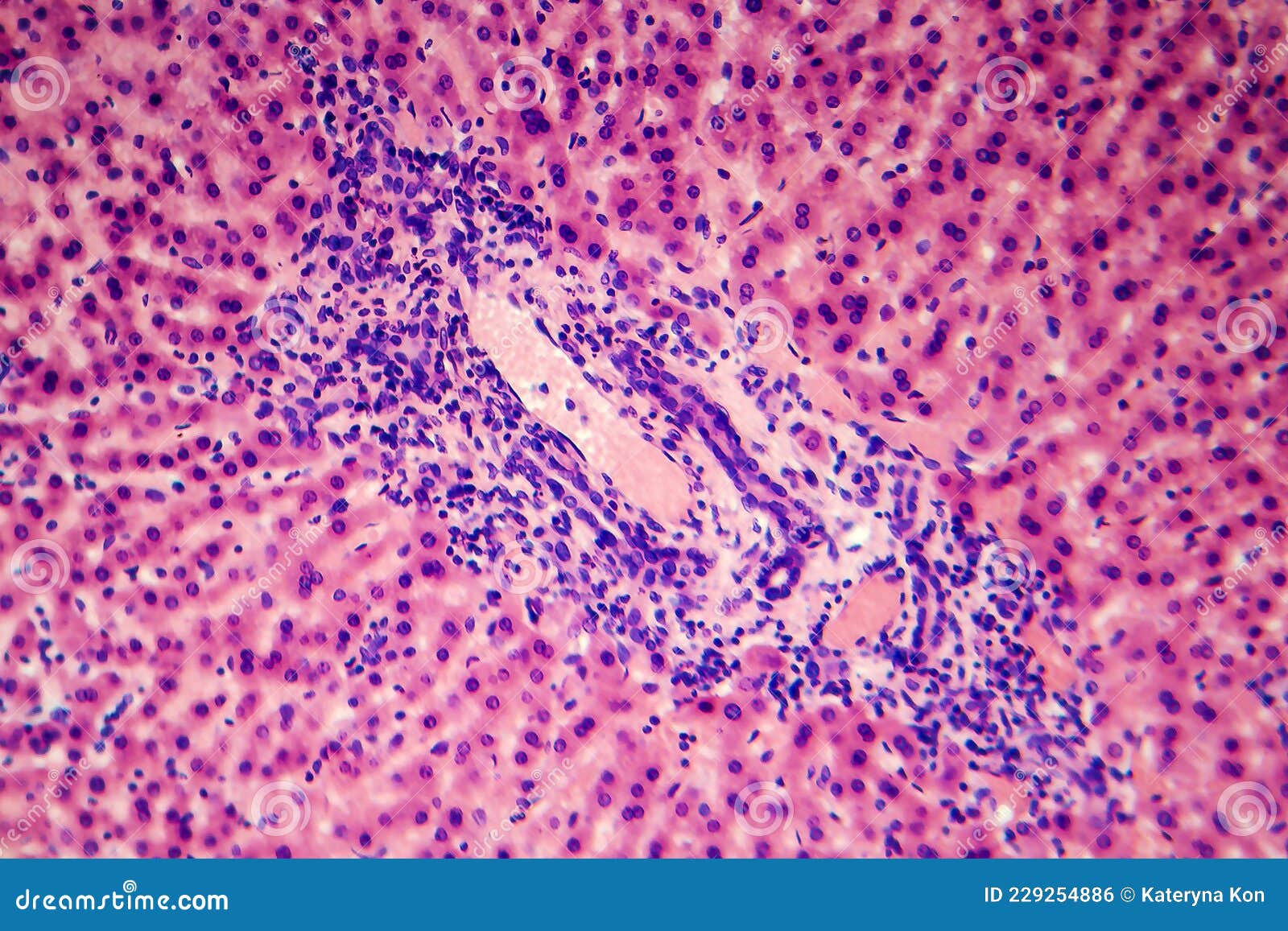 Coccidiosis, Coccidia In Liver, Light Micrograph Stock Photo ...