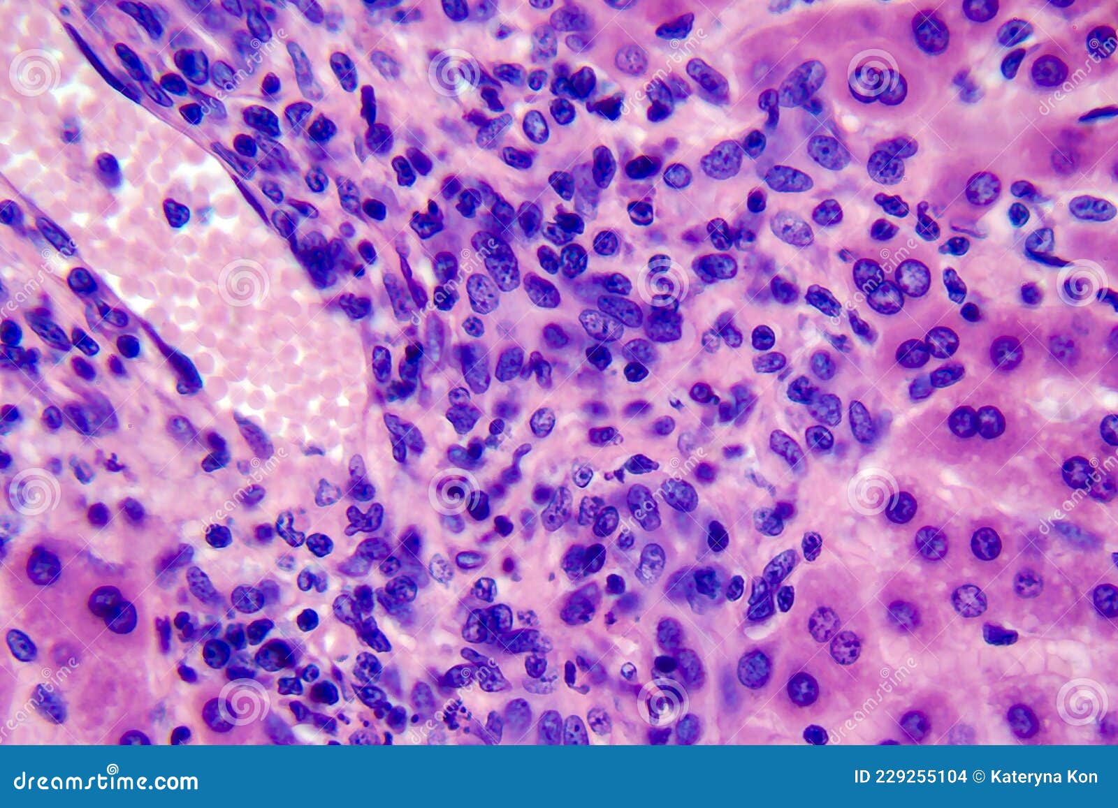 Coccidiosis, Coccidia in Liver, Light Micrograph Stock Photo - Image of ...