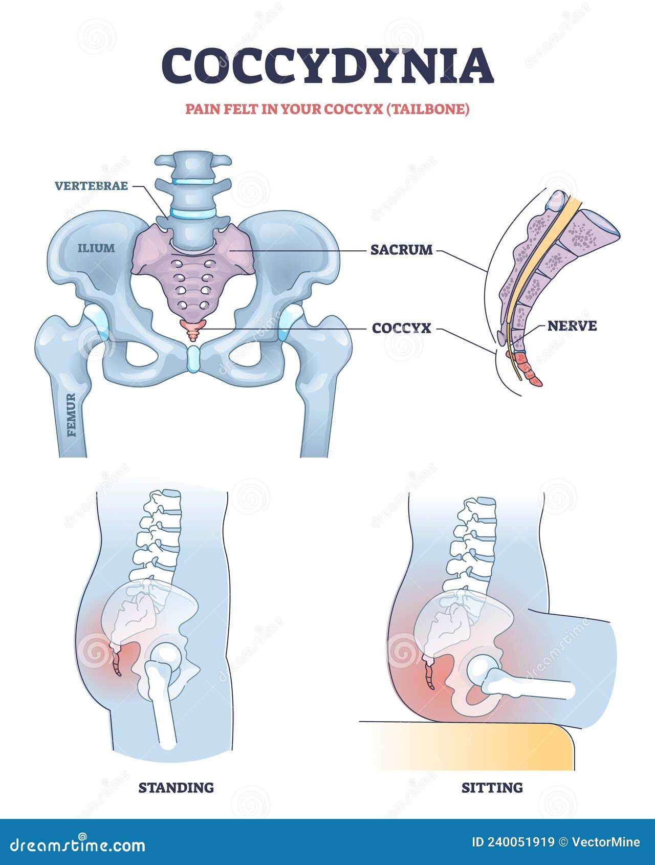 Coccydynia As Pain Felt in Coccyx or Tailbone Anatomical Outline ... Coccydynia As Pain Felt in Coccyx or Tailbone Anatomical Outline ...