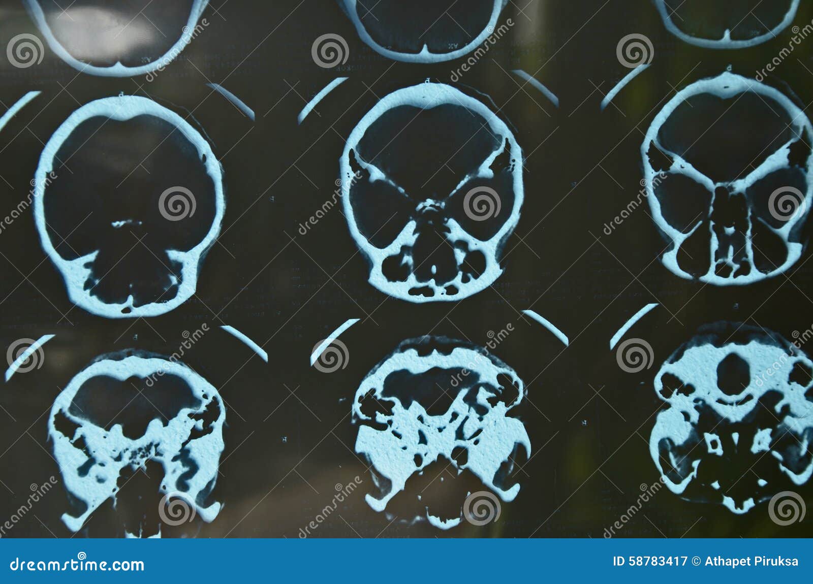 Coconut shell of man stock image. Image of disease, person - 58783417