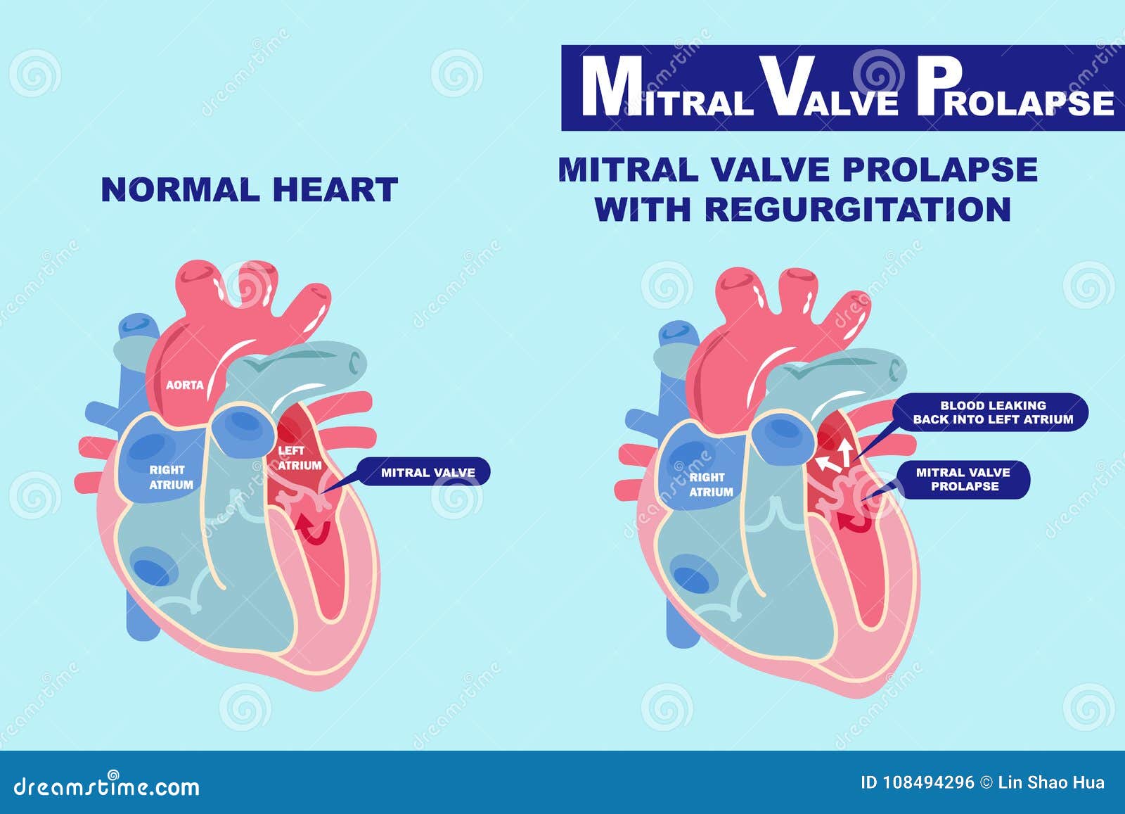 Coeur Avec Le Prolapsus Valvulaire Mitral Illustration de Vecteur ...