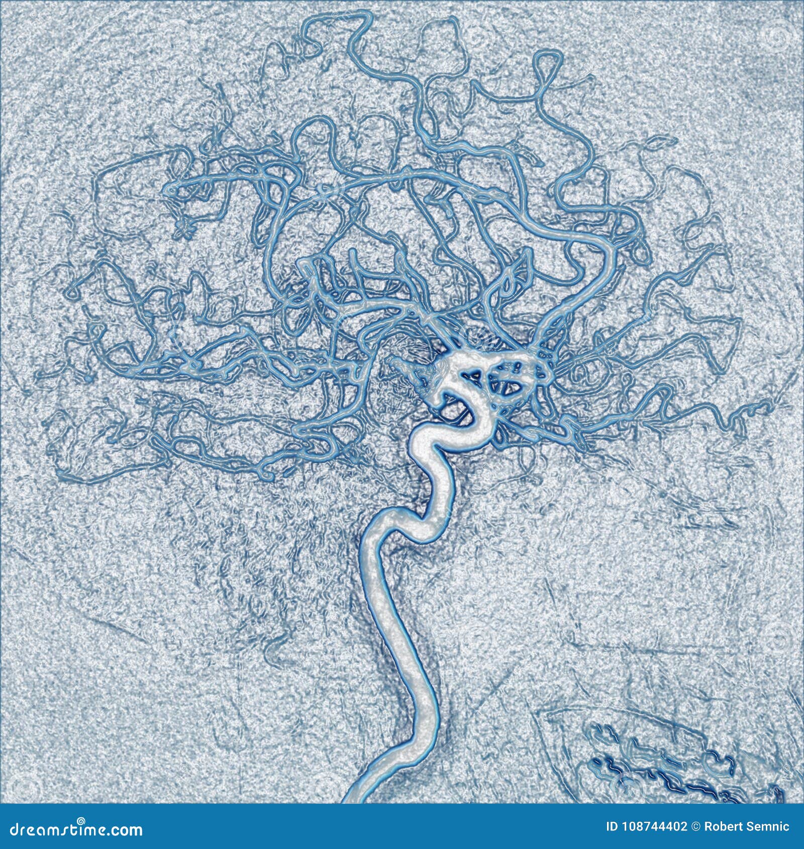 Coiling of the Cerebral Aneurysm, Angiography Stock Photo - Image of ...