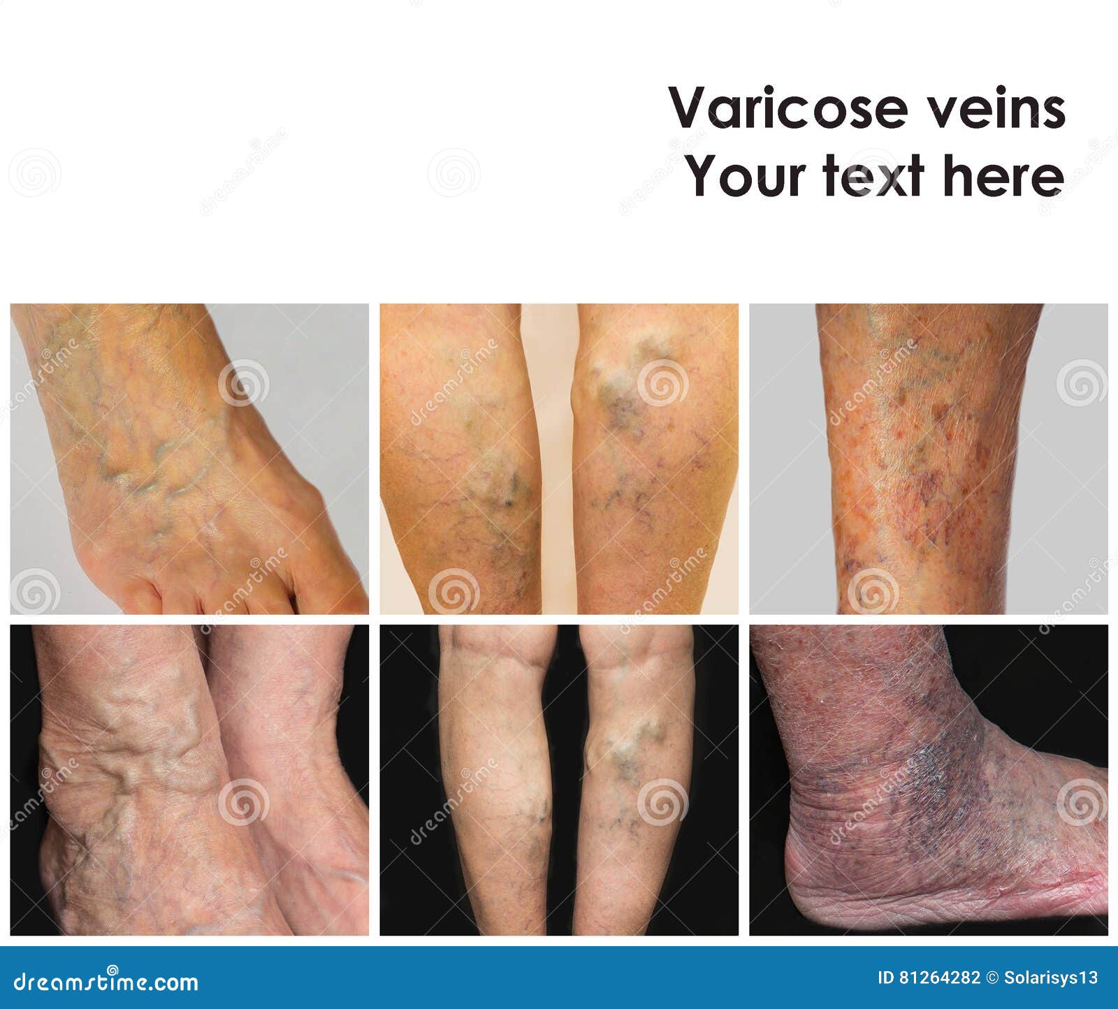 Colagem Das Imagens Das Veias Varicosas Foto de Stock - Imagem de edema ...