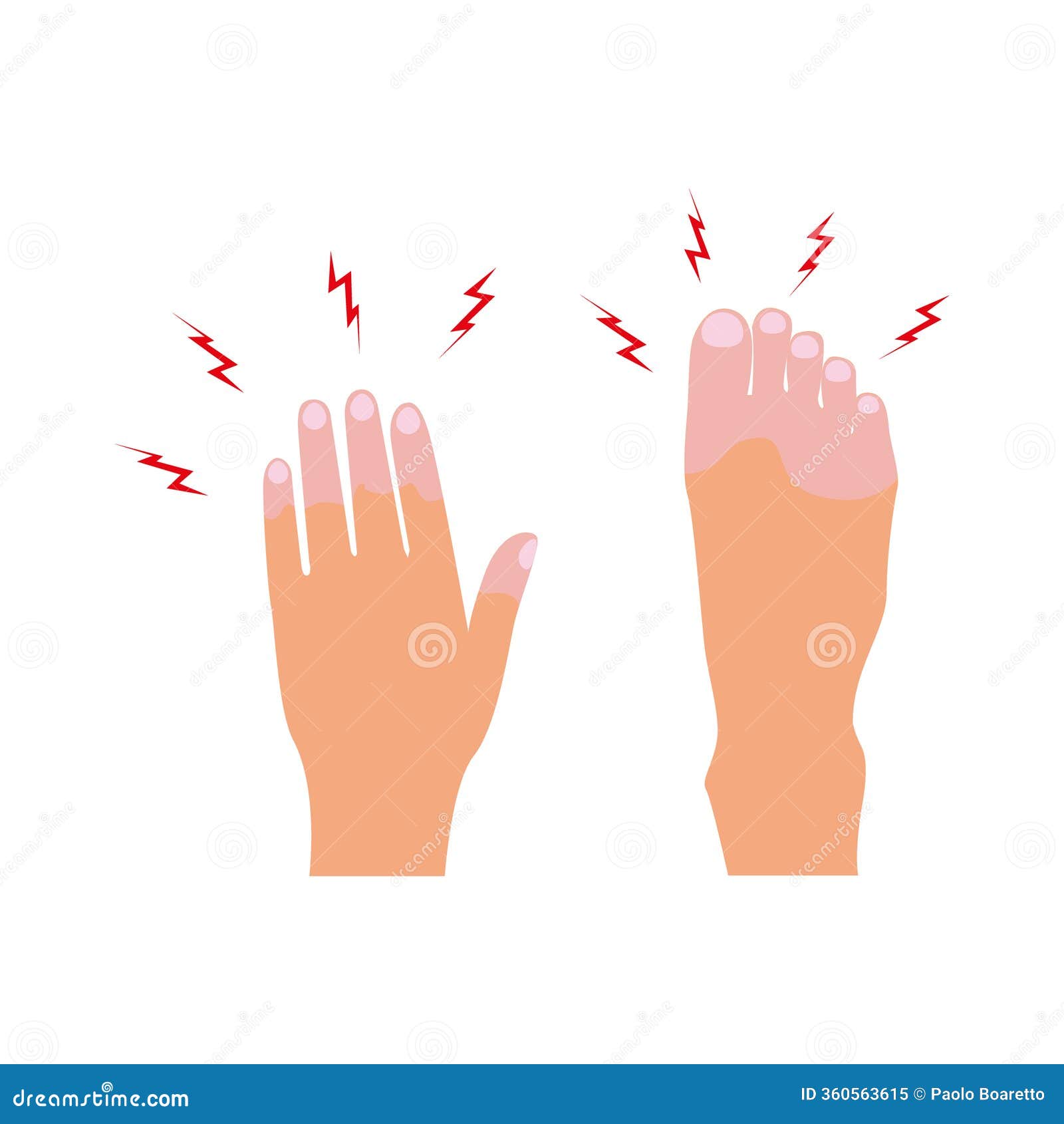 Cold And Numbness At The Fingertips. Vector Illustration Of Feet And ...