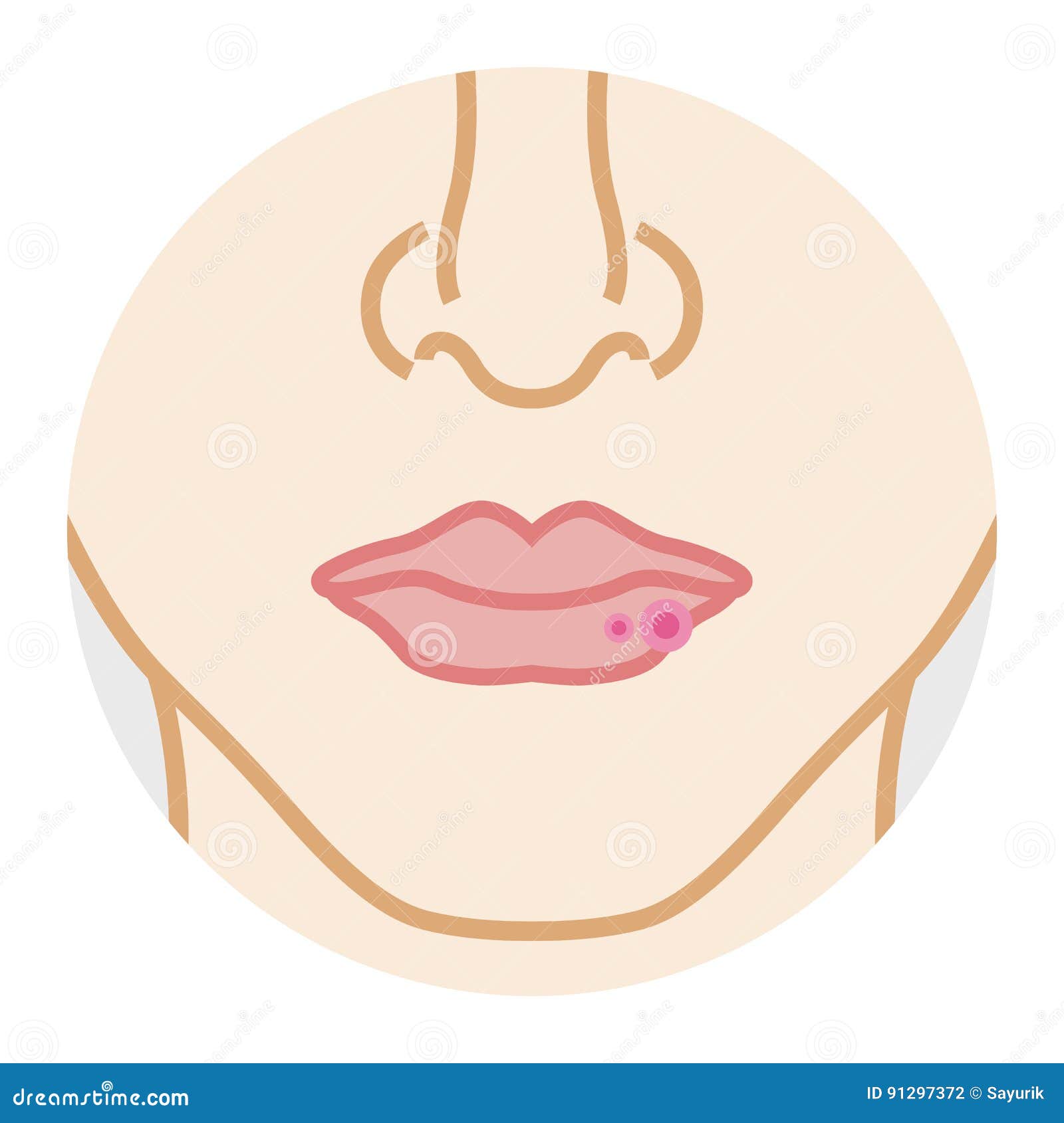 Cold Sore - Face Close-up stock vector. Illustration of cold - 91297372