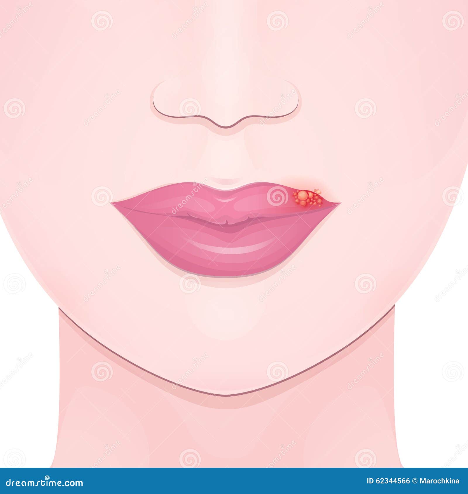 Cold sore lip stock vector. Illustration of injury, bubble - 62344566