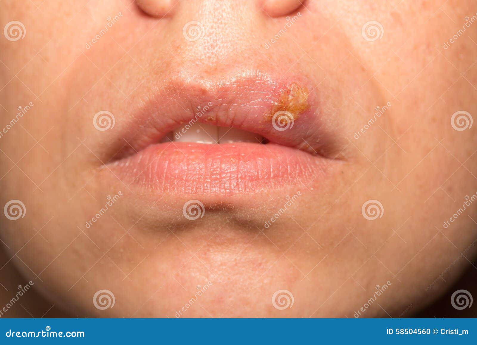 Cold sore stock photo. Image of macro, dermatology, disease - 58504560