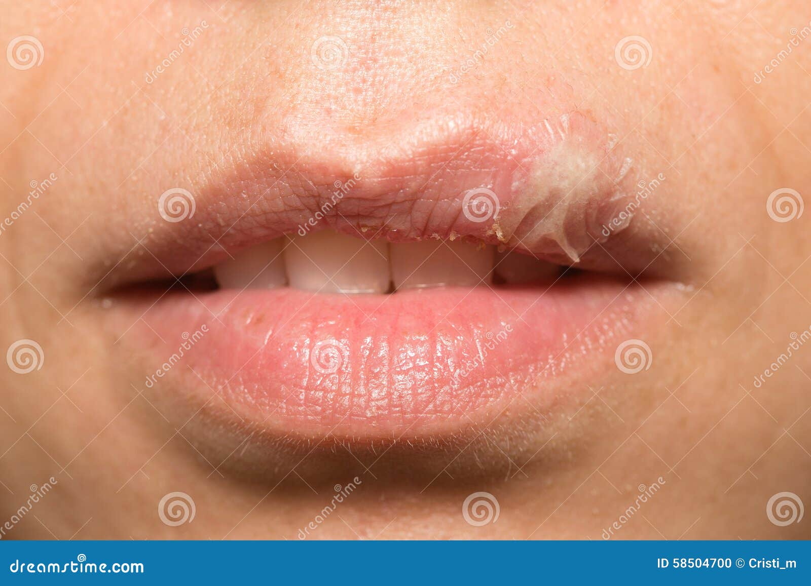 Cold sore stock photo. Image of crusted, skin, illness - 58504700