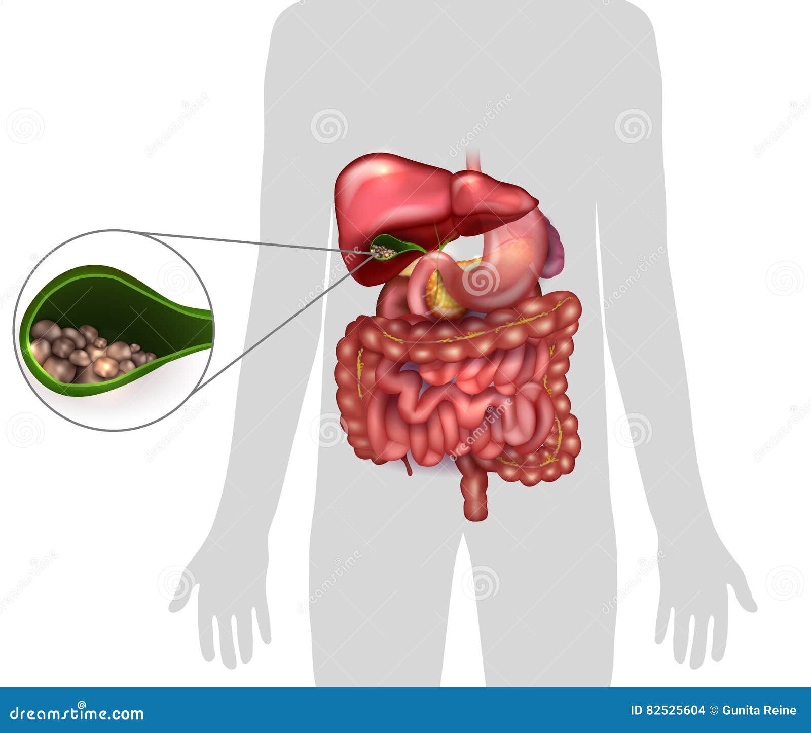 Colelitiasi Nella Cistifellea Illustrazione Vettoriale - Illustrazione ...