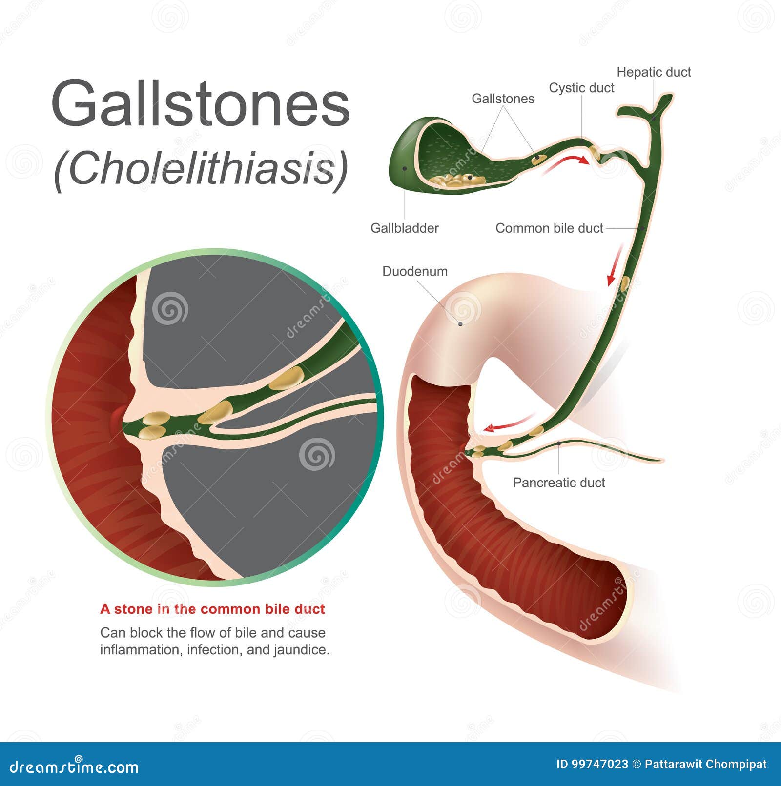 Colelitiasis De Los Cálculos Biliares Ilustración del Vector ...