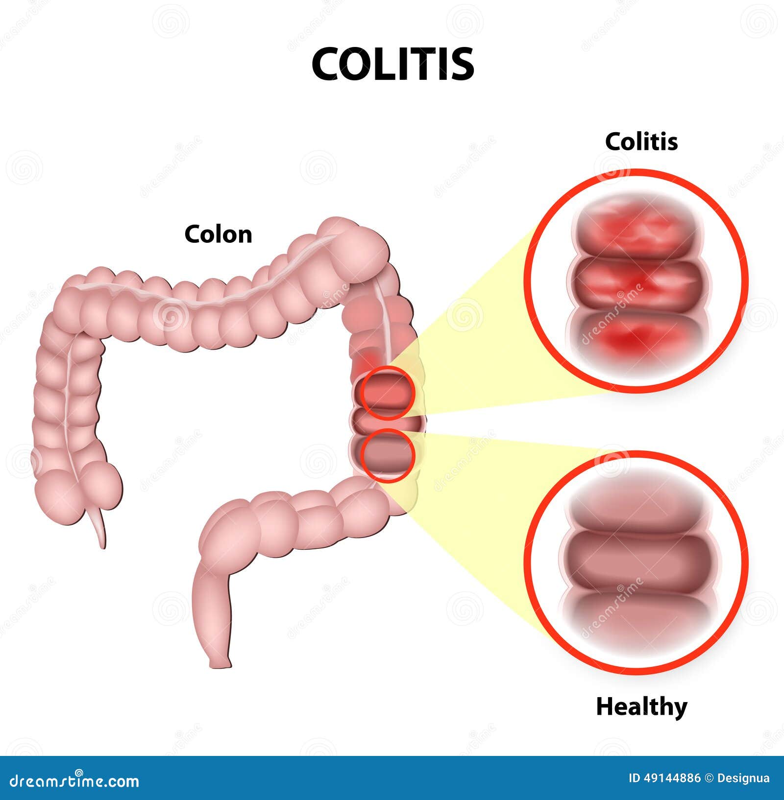 Colites illustration de vecteur. Illustration du grand - 49144886