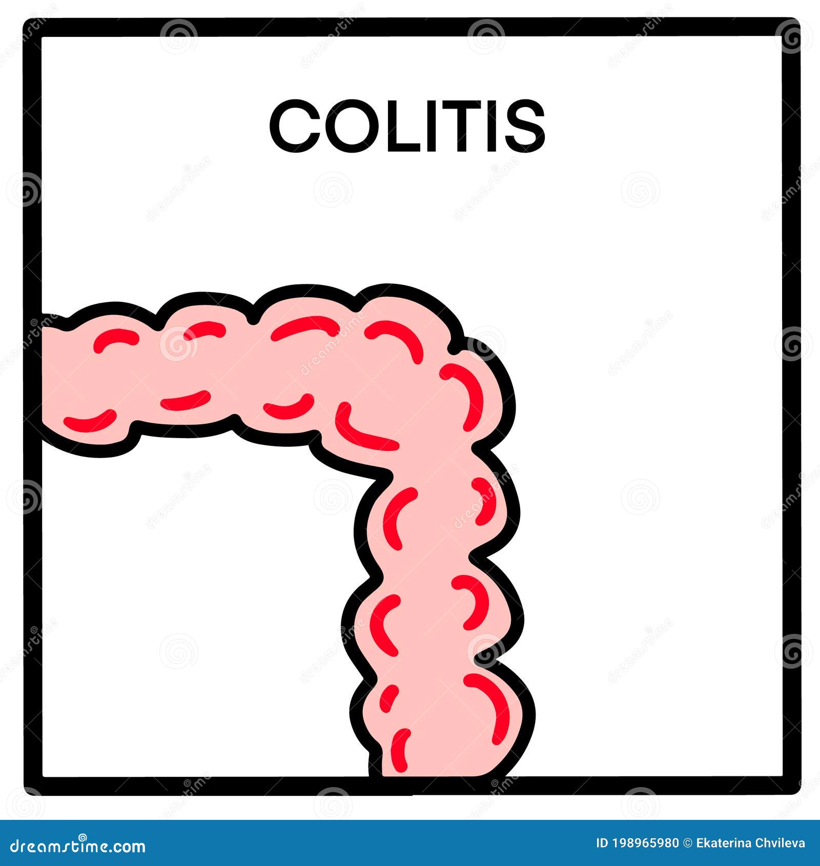 Colitis Hand Drawn Vector Illustration in Cartoon Comic Style Stock ...