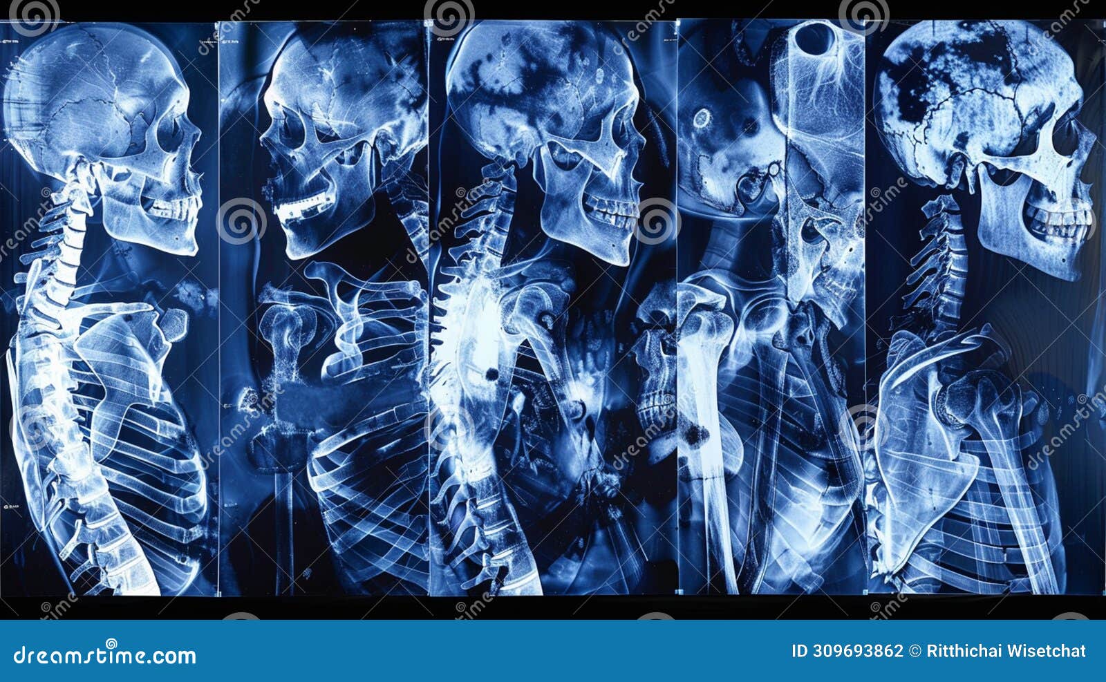 A Collage of Detailed Blue-toned X-ray Images Showcasing Various Angles ...