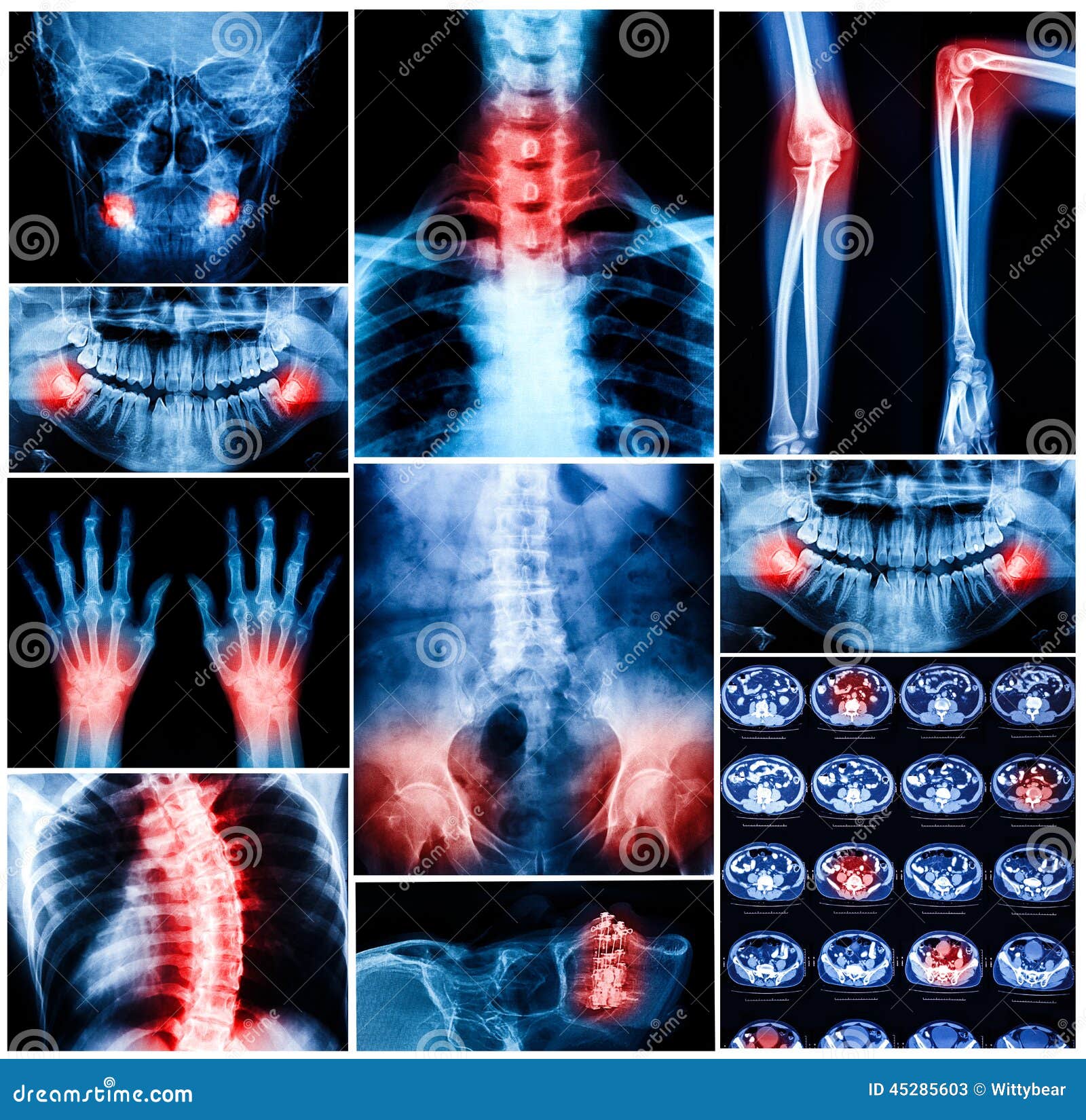 Collage of Human X-rays Photo Stock Image - Image of scan, radiology ...