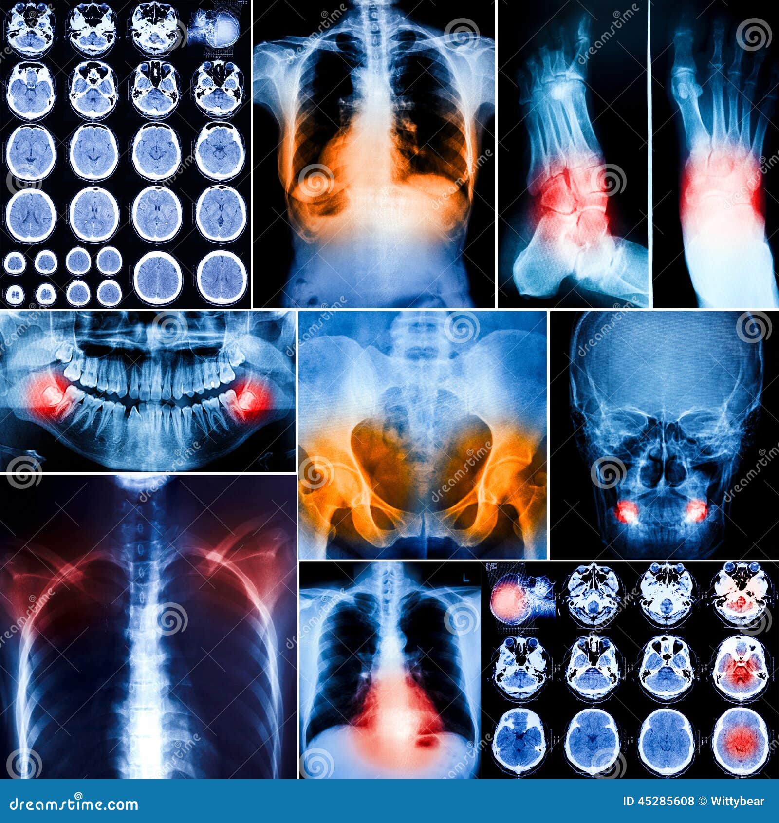 Collage of Human X-rays Photo Stock Photo - Image of injury, bone: 45285608