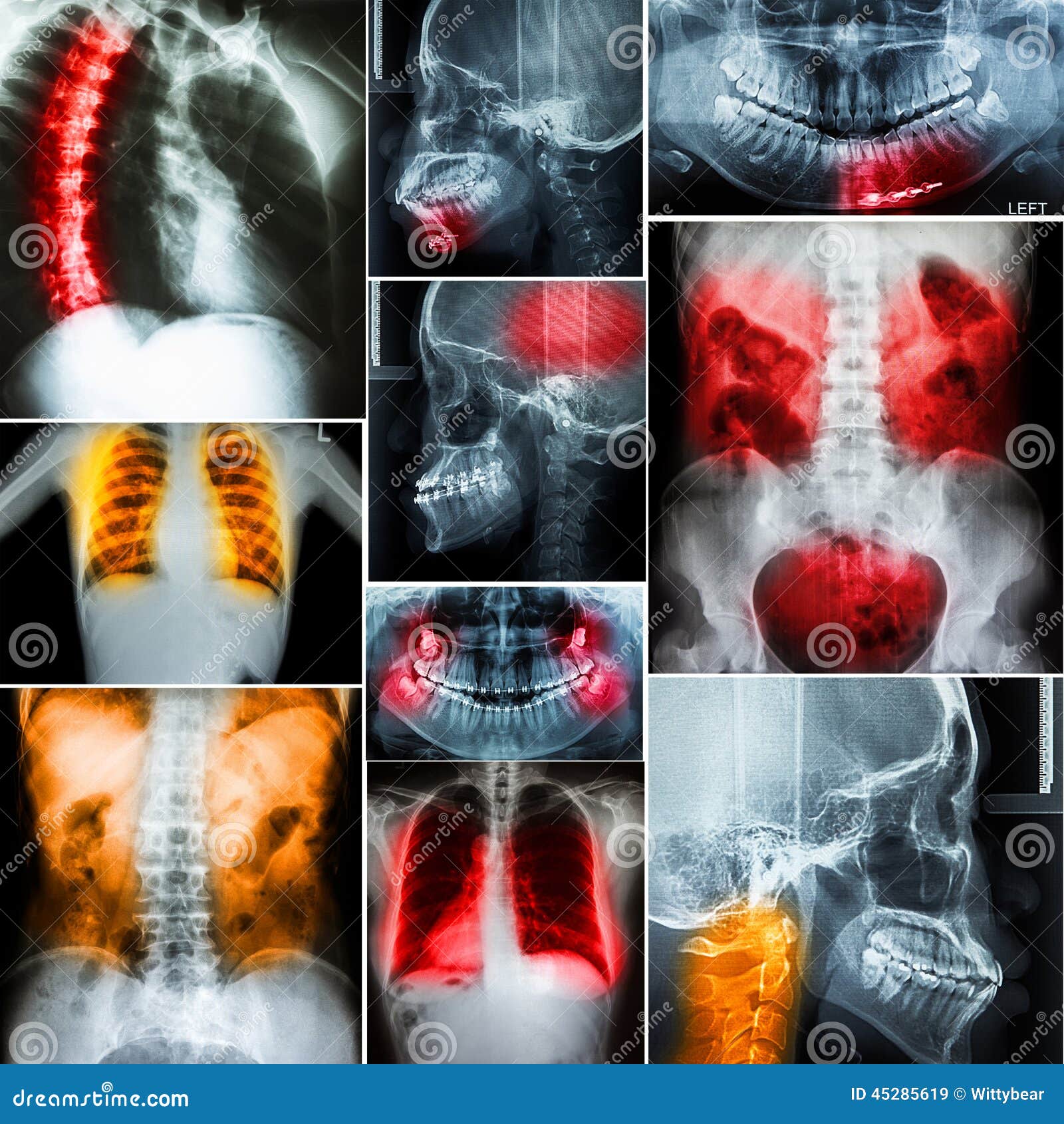 Collage of Human X-rays Photo Stock Image - Image of human, medicine ...