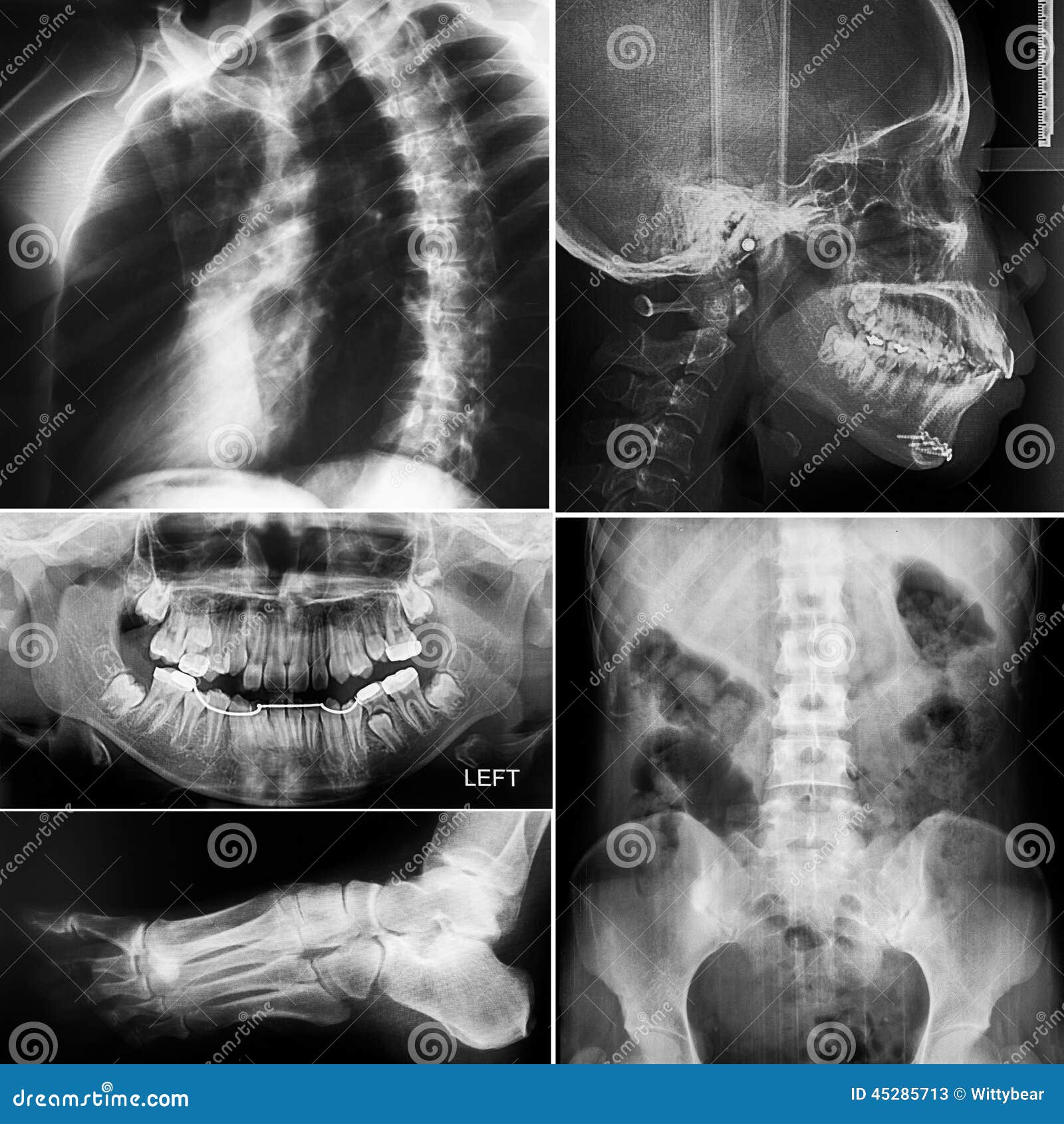 Collage of Human X-rays Photo Stock Image - Image of neck, atomy: 45285713