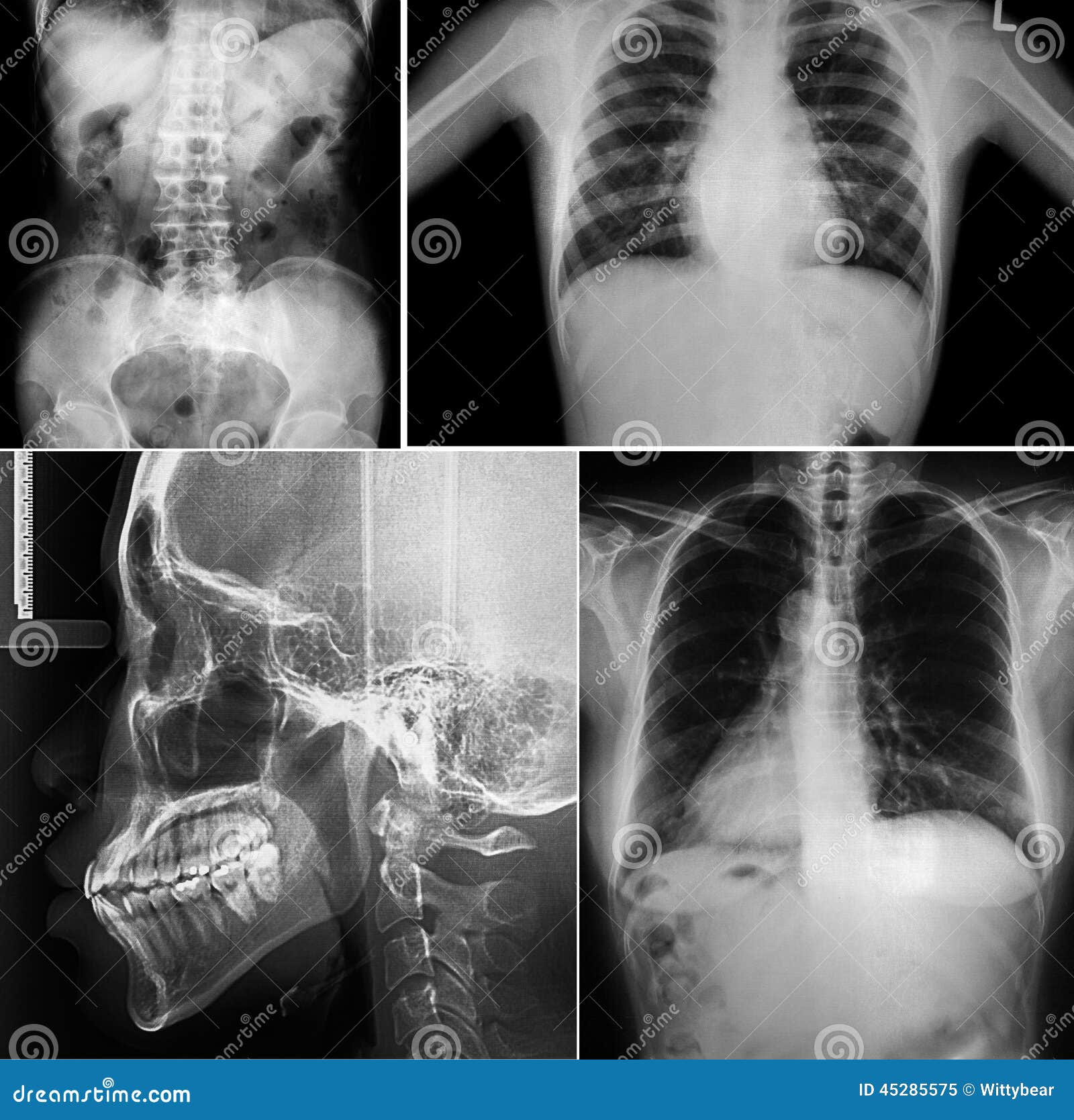 Collage Of Human X-rays Photo Royalty-Free Stock Photography ...