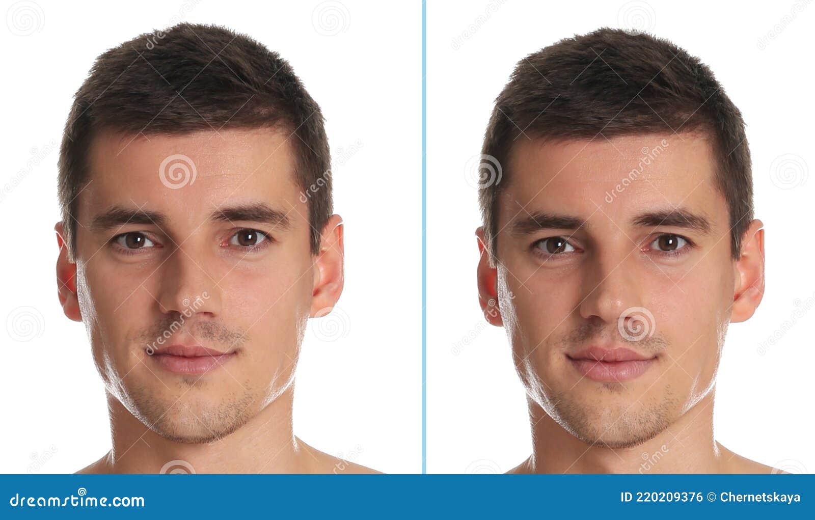 Collage with Photos of Man before and after Lips Augmentation Stock ...