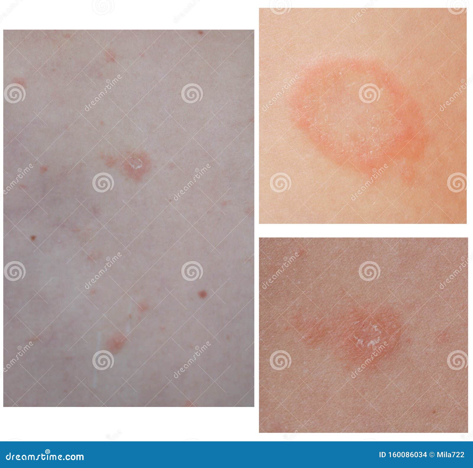 Collage of Pityriasis Rosea Rash. Stock Photo - Image of diagnosis ...