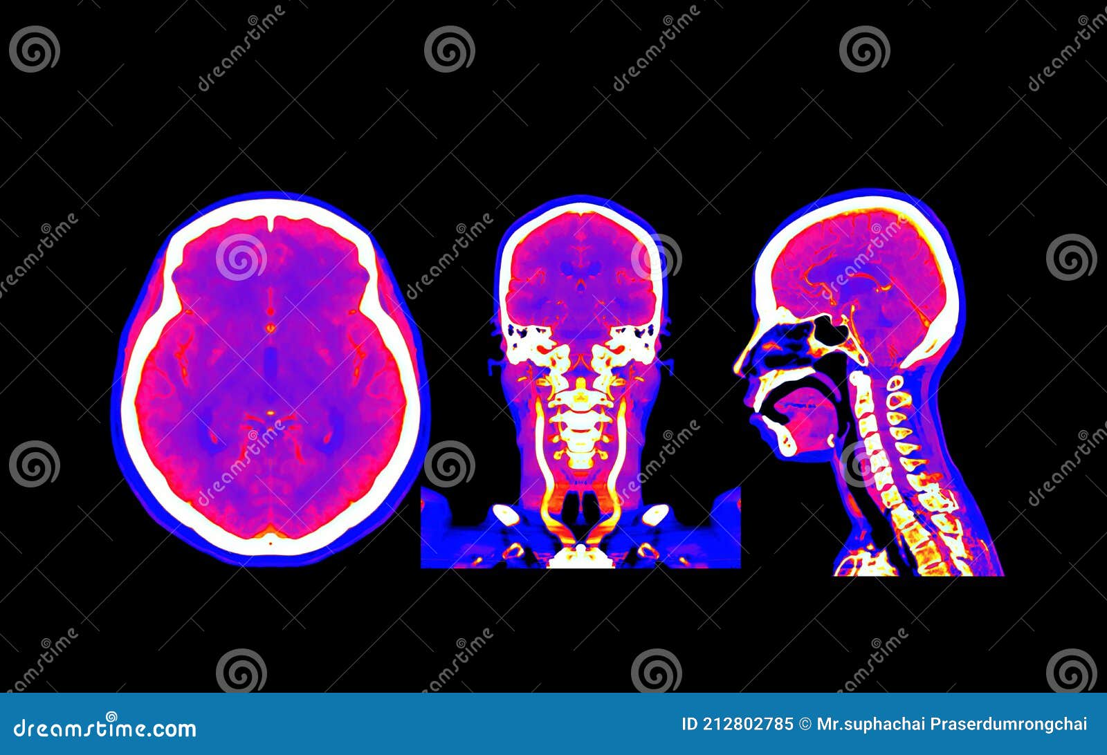Colorful Of CT Angiography Of The Brain Or CTA Brain Comparison Axial ... Colorful Of CT Angiography Of The Brain Or CTA Brain Comparison Axial ...