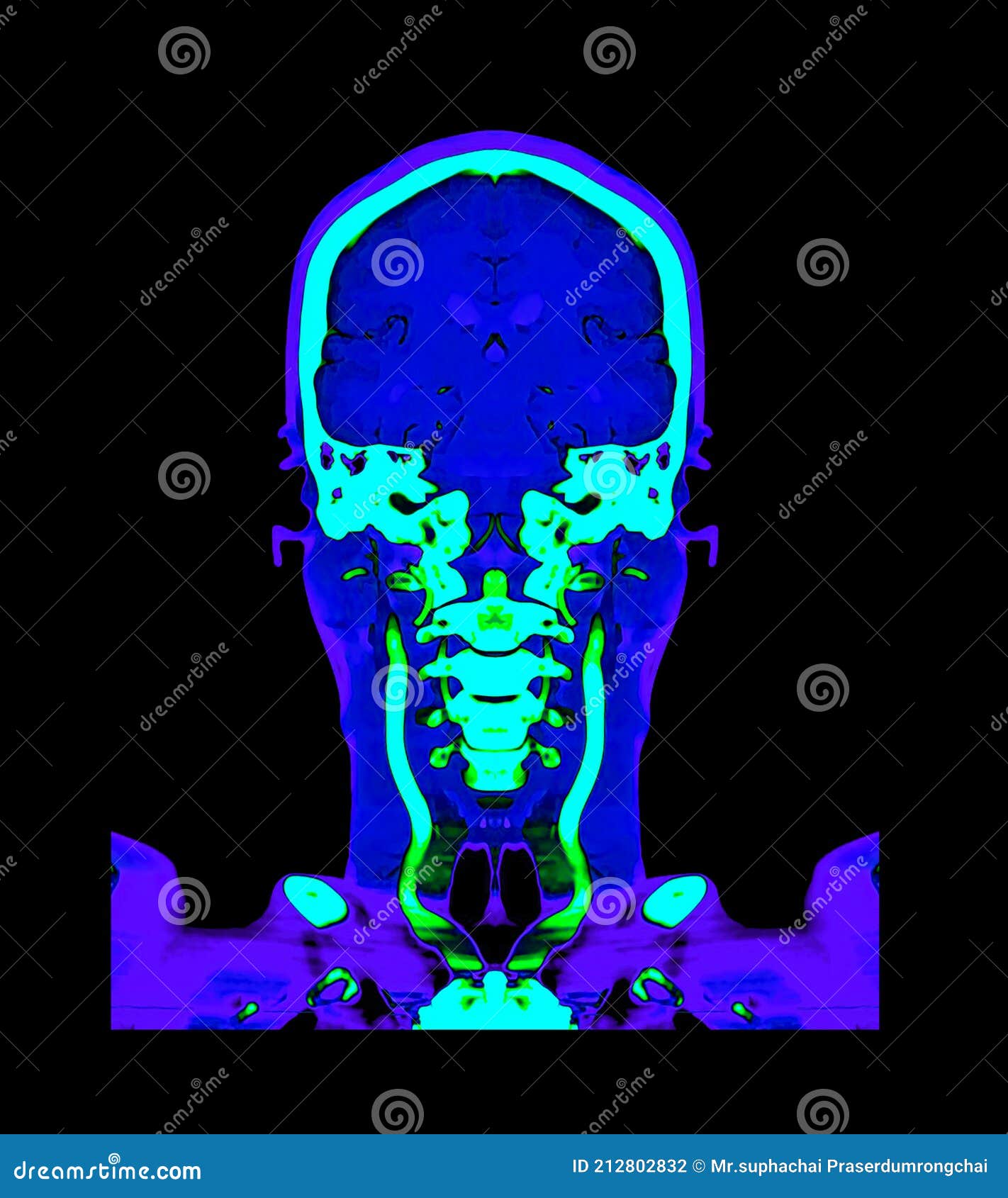 Collection Colorful of CT Angiography of the Brain or CTA Brain ...