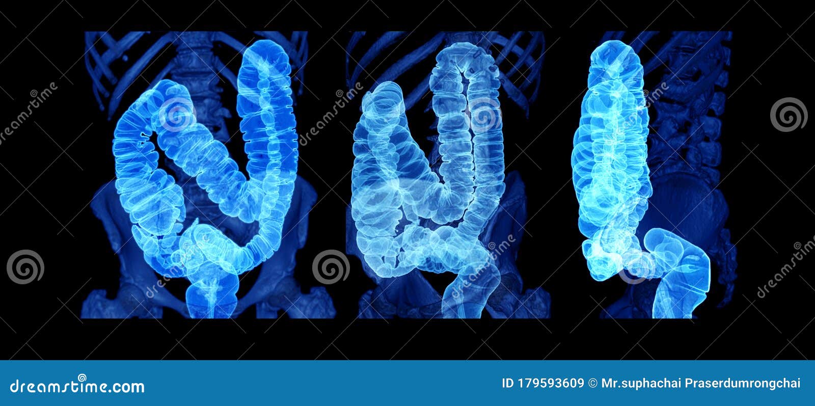 Collection Of CT Colonography Or CT Scan Of Colon 3D Rendering Image ... Collection Of CT Colonography Or CT Scan Of Colon 3D Rendering Image ...