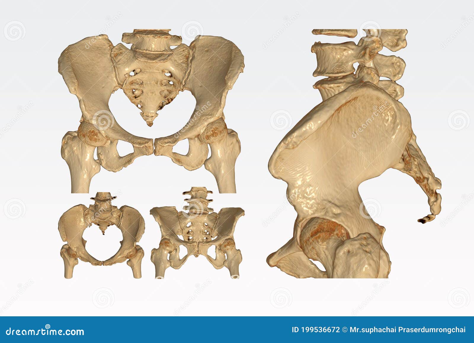 Collection of CT Scan Pelvic Bone with Both Hip Joint 3D Rendering ... Collection of CT Scan Pelvic Bone with Both Hip Joint 3D Rendering ...