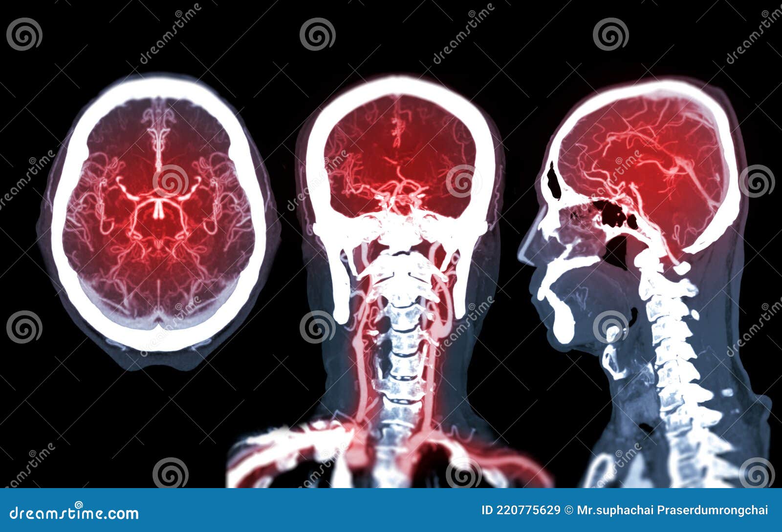 Collection Of CTA Brain Or CT Angiography Of The Brain Comparison Mip ... Collection Of CTA Brain Or CT Angiography Of The Brain Comparison Mip ...