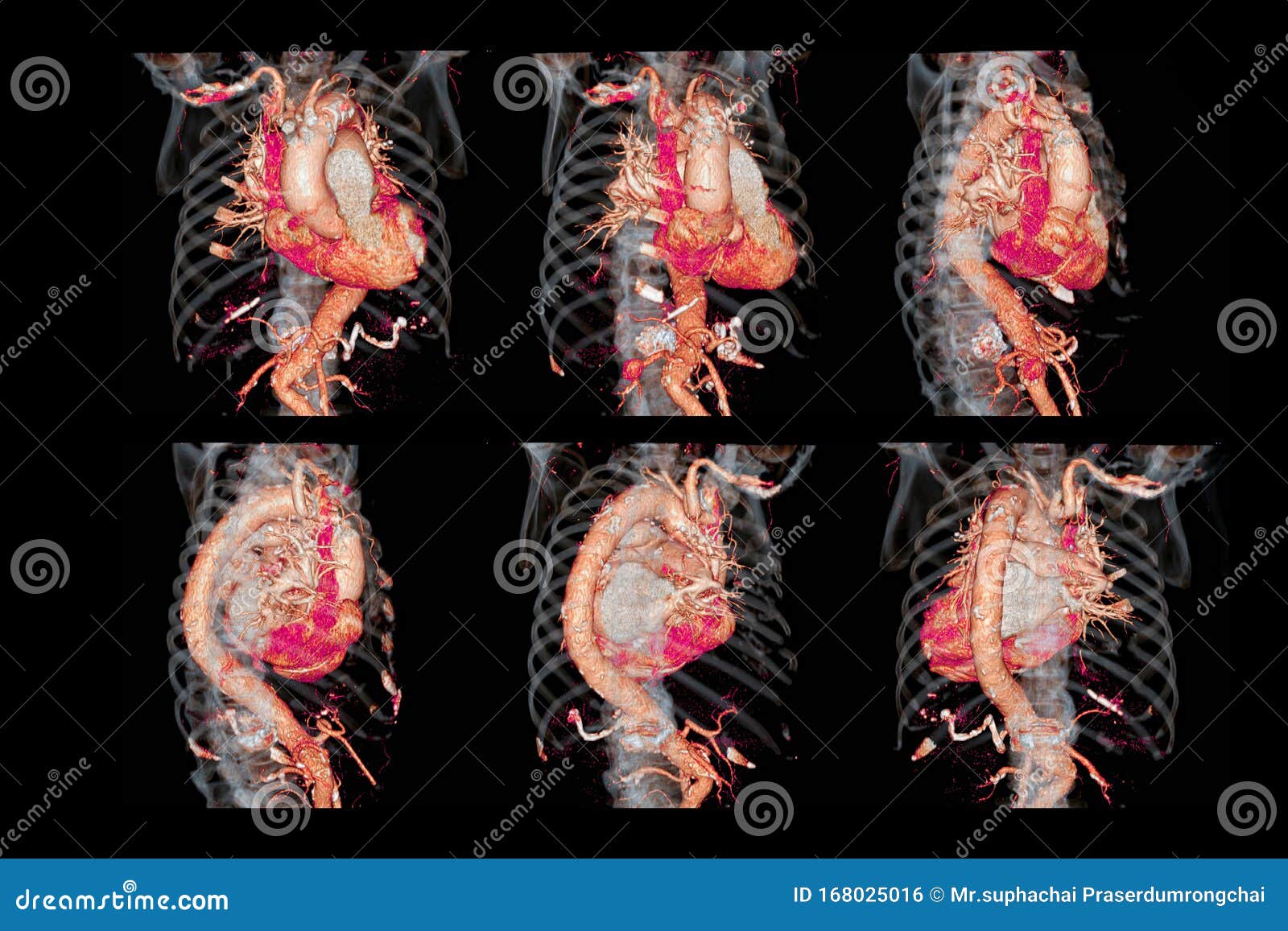 Collection of CTA Thoracic Aorta 3D Rendering Image. Stock Illustration ...