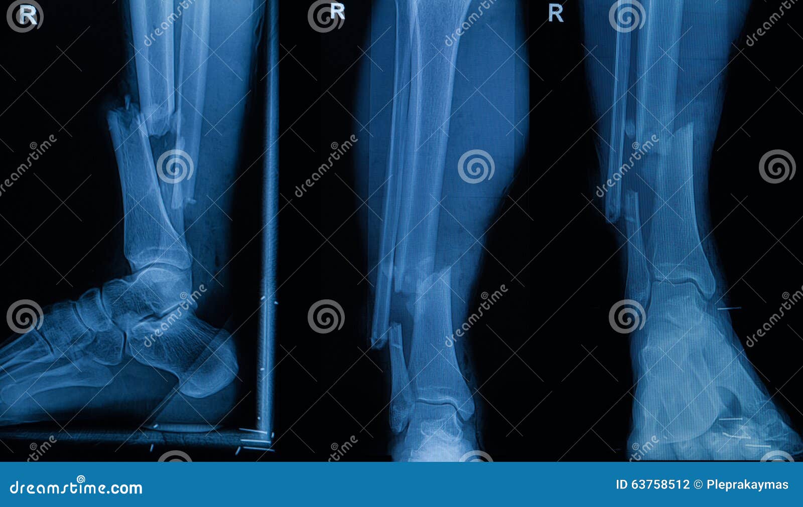 Collection of Human X-rays Showing Fracture of Right Leg Stock Photo ...