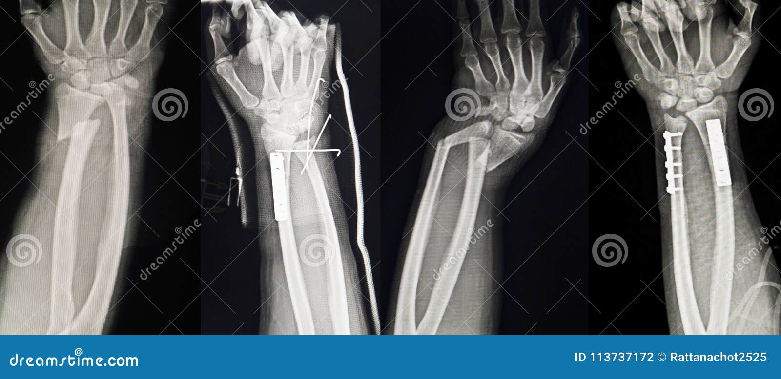Collection of Human X-rays Showing Multiple Hand Fracture. Stock Photo ...