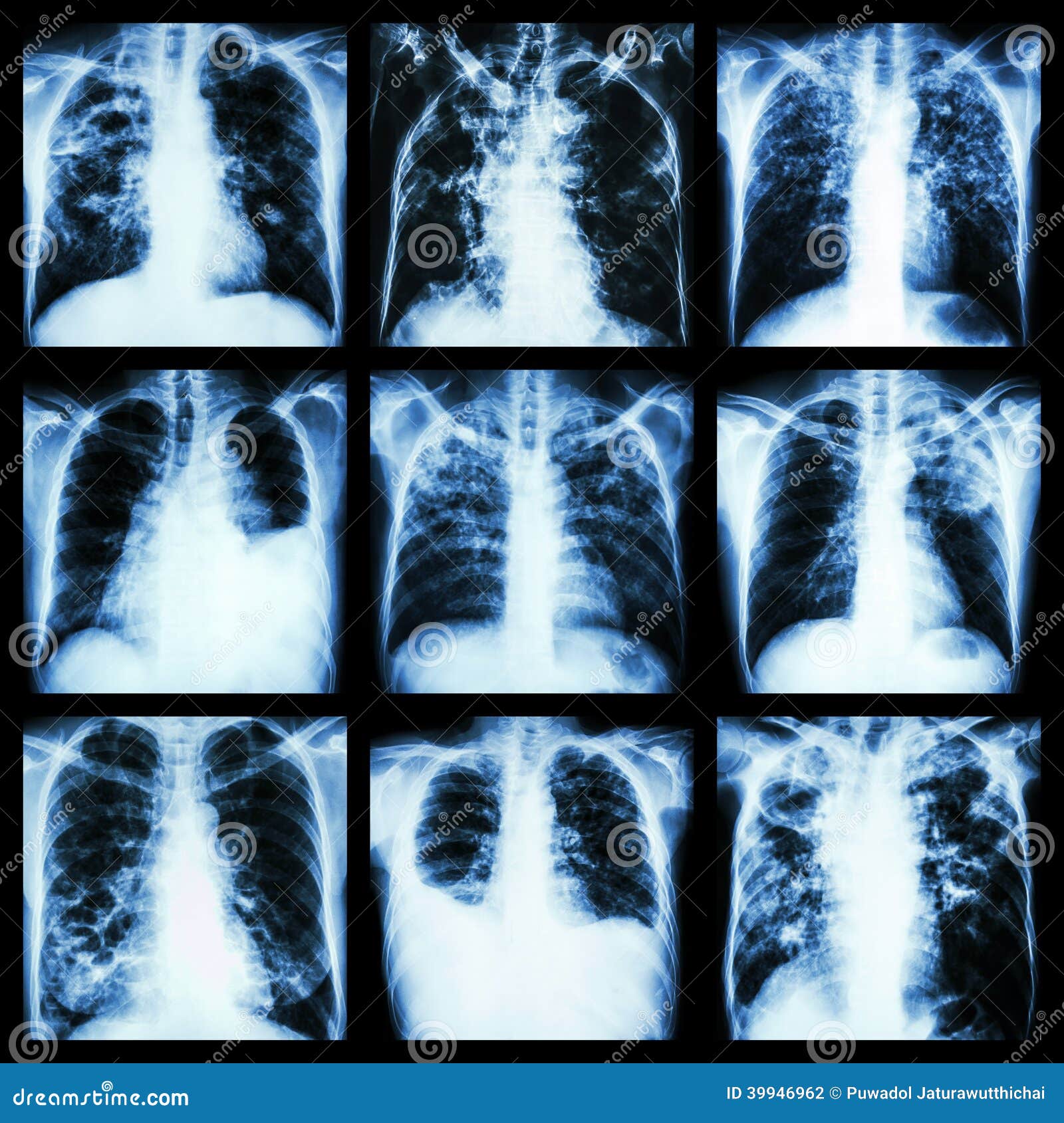 Bronchiectasis . X-ray Chest Show Multiple Lung Bleb And Cyst Due To ...