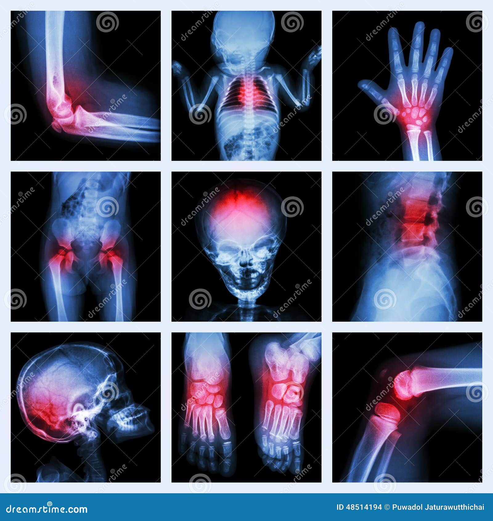 Collection X-ray Part of Child and Multiple Injury Stock Photo - Image ...