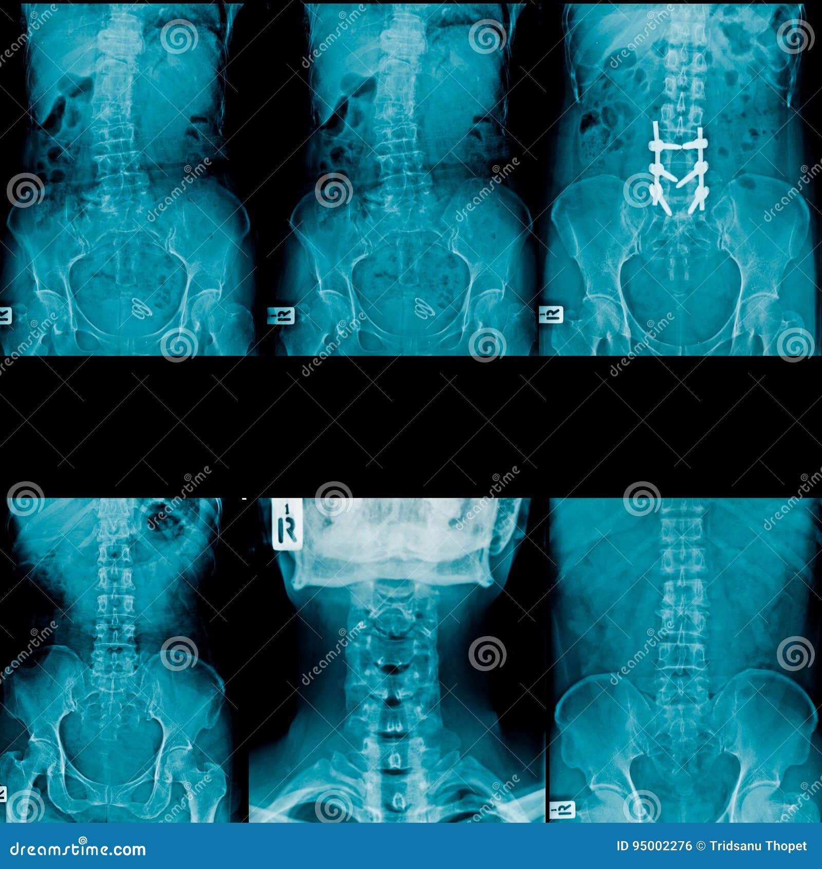 Collection x-ray spine stock photo. Image of bend, black - 95002276