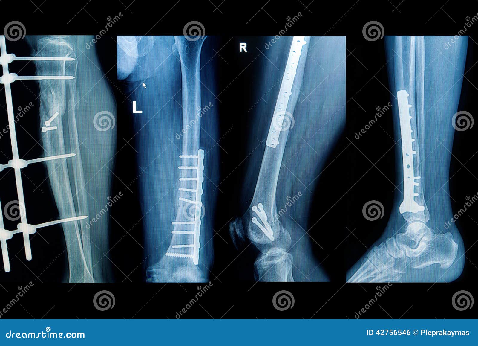 Collection X-rays Image of Fracture Lower Extremity Stock Photo - Image ...
