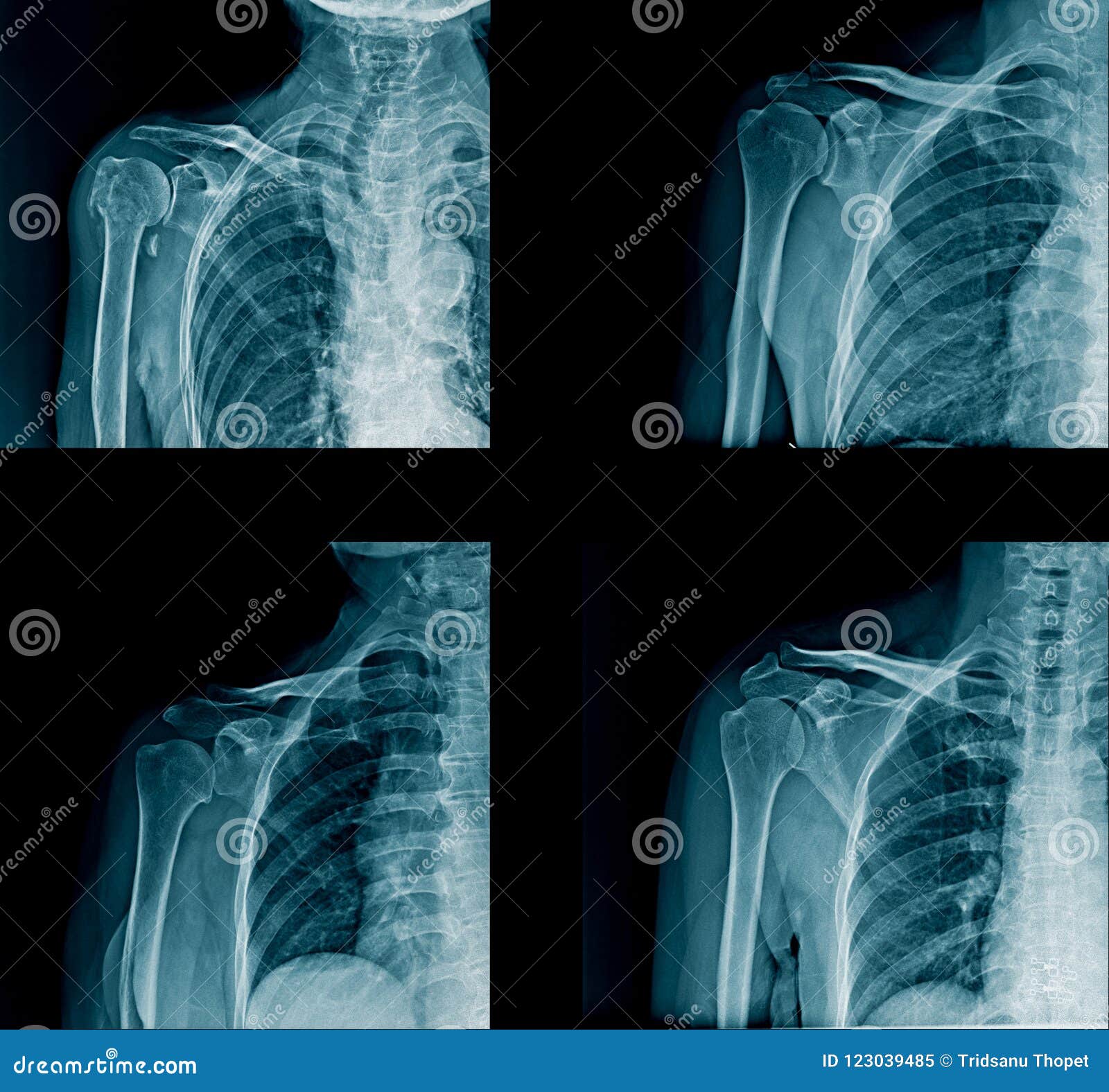 Collection Shoulder X-ray Image Stock Image - Image of film, diagnostic ...