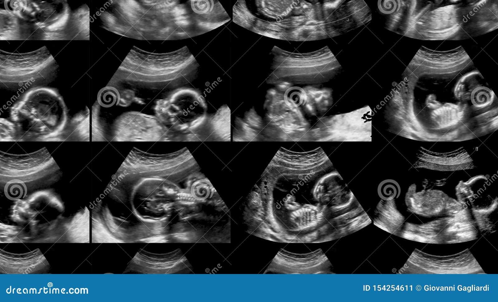 Collection of Ultrasonography Fetus Scans Stock Image - Image of ...