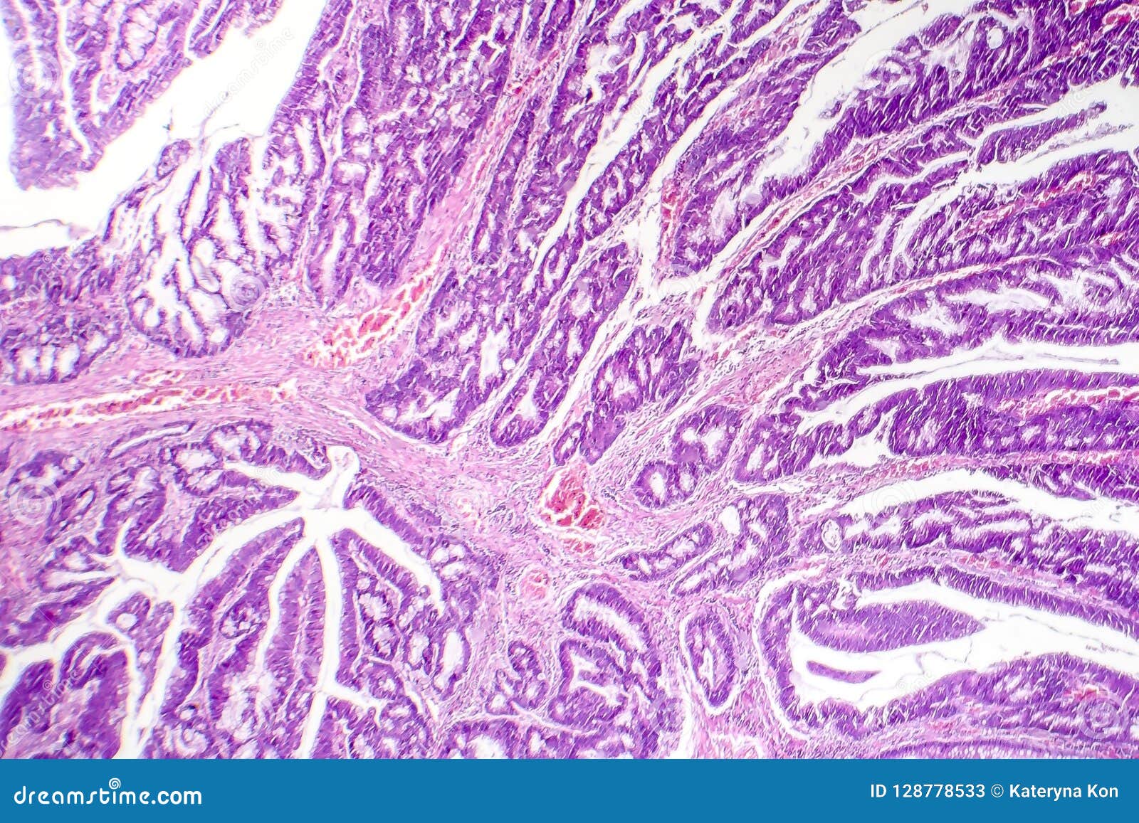 Colon Adenocarcinoma, Cancer of Colon Stock Image - Image of neoplasm ...