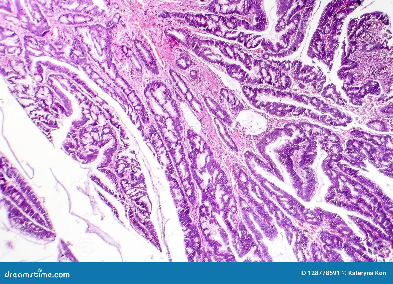 Colon Adenocarcinoma, Cancer of Colon Stock Image - Image of ...