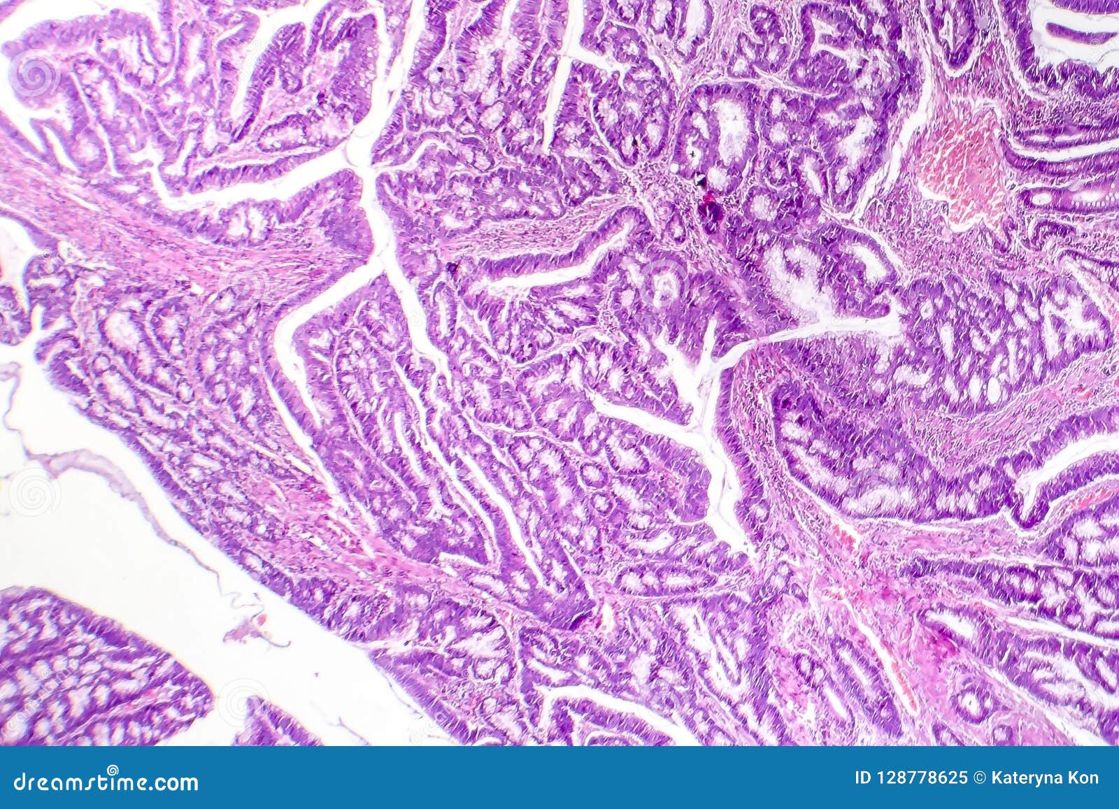 Colon Adenocarcinoma, Cancer of Colon Stock Image - Image of large ...