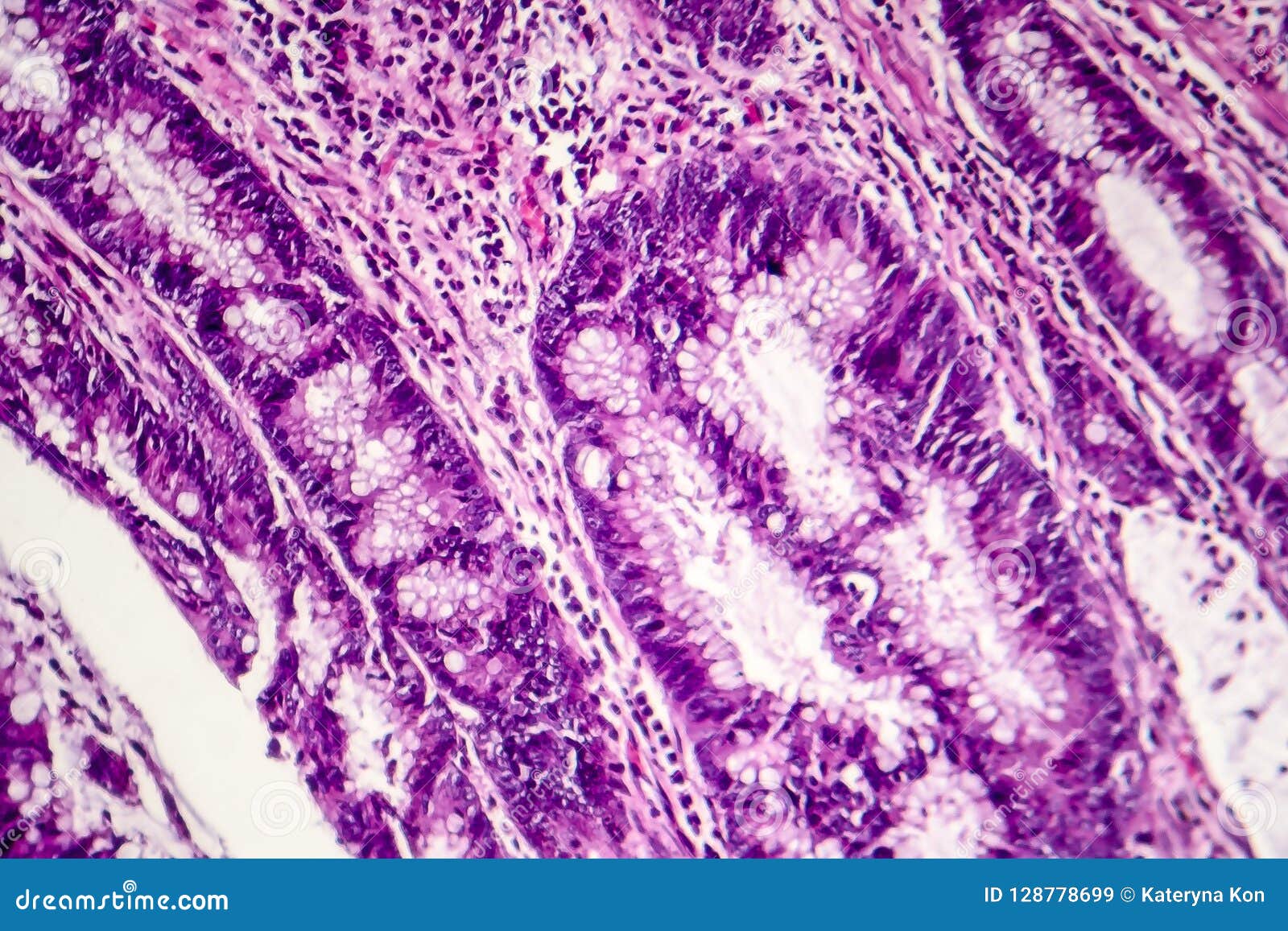 Colon Adenocarcinoma, Cancer of Colon Stock Image - Image of oncology ...