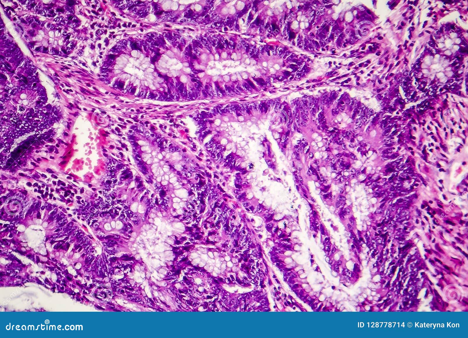 Colon Adenocarcinoma, Cancer of Colon Stock Photo - Image of colon ...