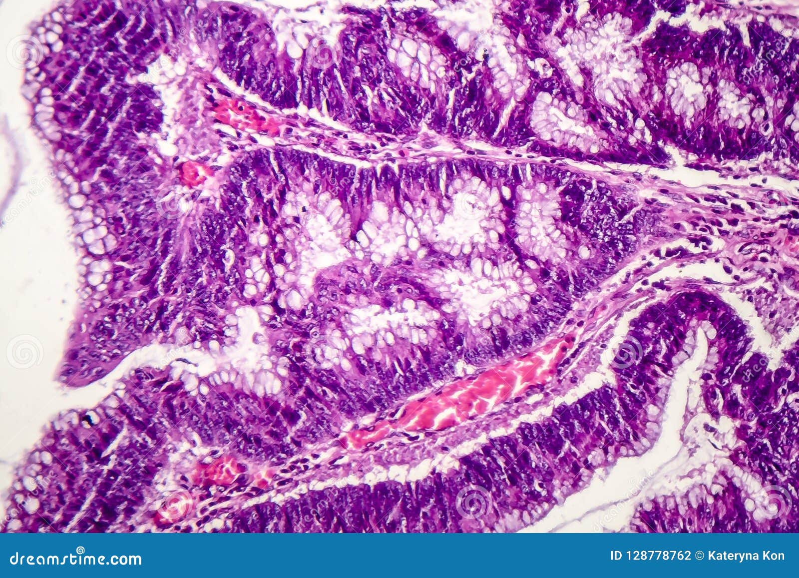 Colon Adenocarcinoma, Cancer of Colon Stock Photo - Image of ...